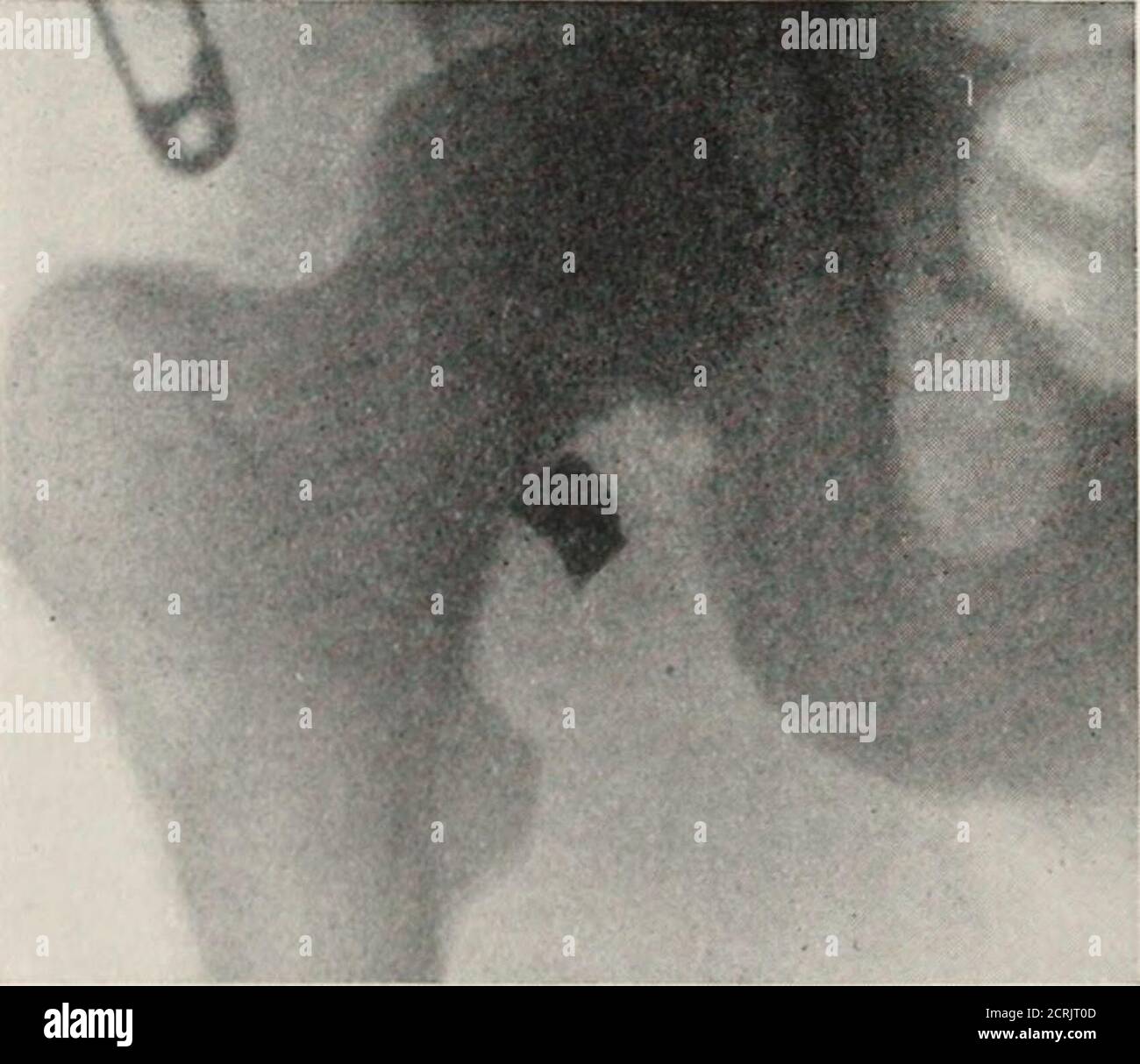 Foreignbody hi-res stock photography and images - Alamy