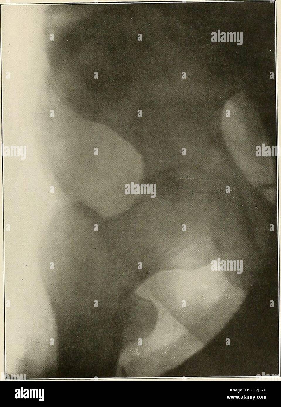 Normal hip xray pathologic fracture hip xray - medicress