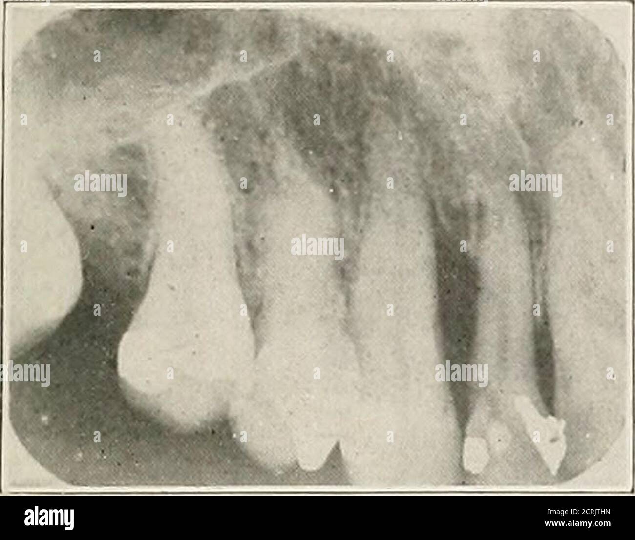 . Interpretation of dental and maxillary roentgenograms . Fig. 116. Fig ...