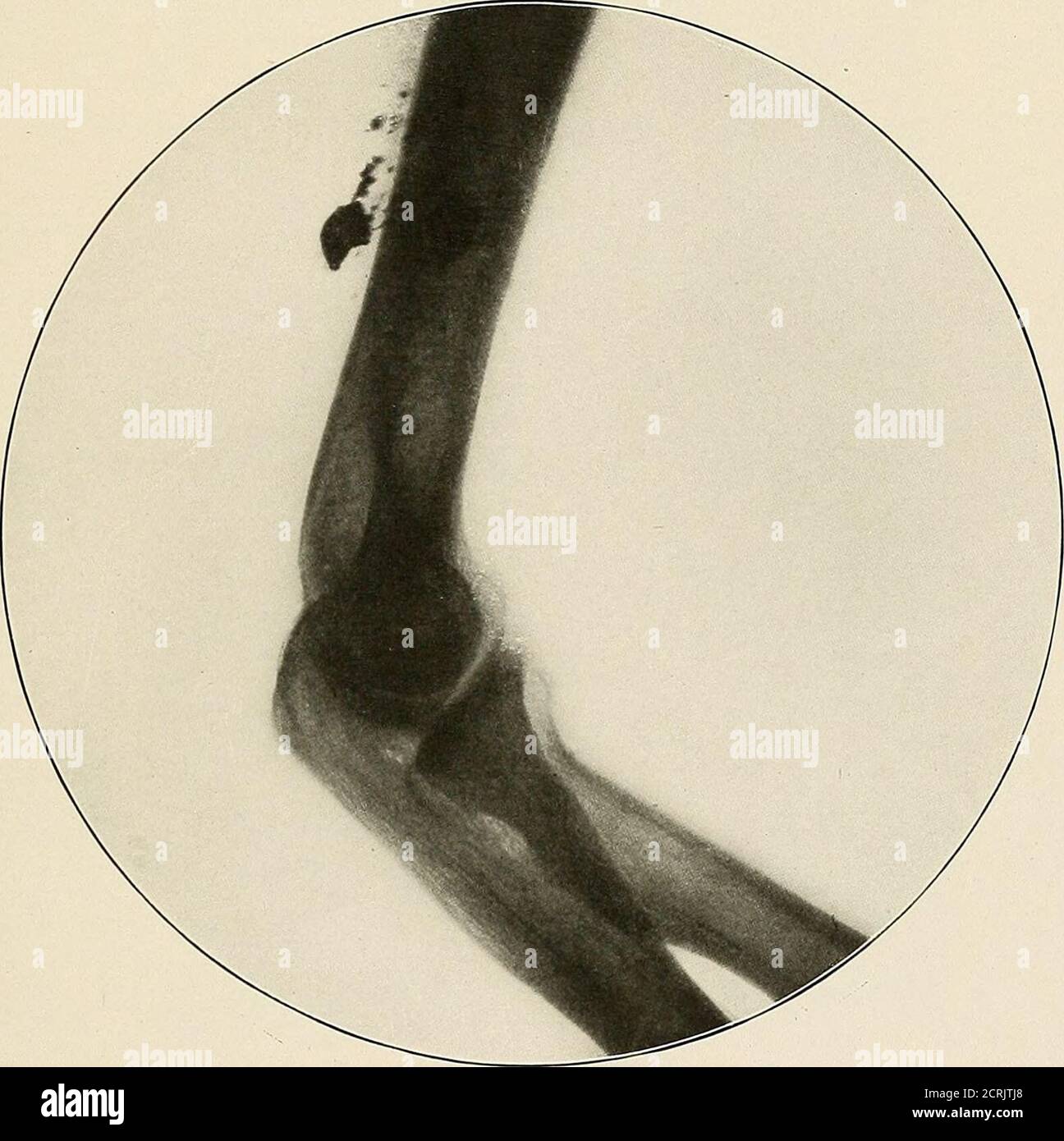 Hip bone contusion hi-res stock photography and images - Alamy