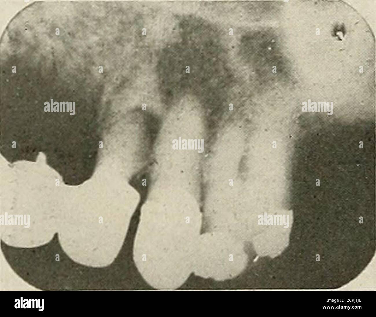 . Interpretation of dental and maxillary roentgenograms . Fig. 114. Fig ...