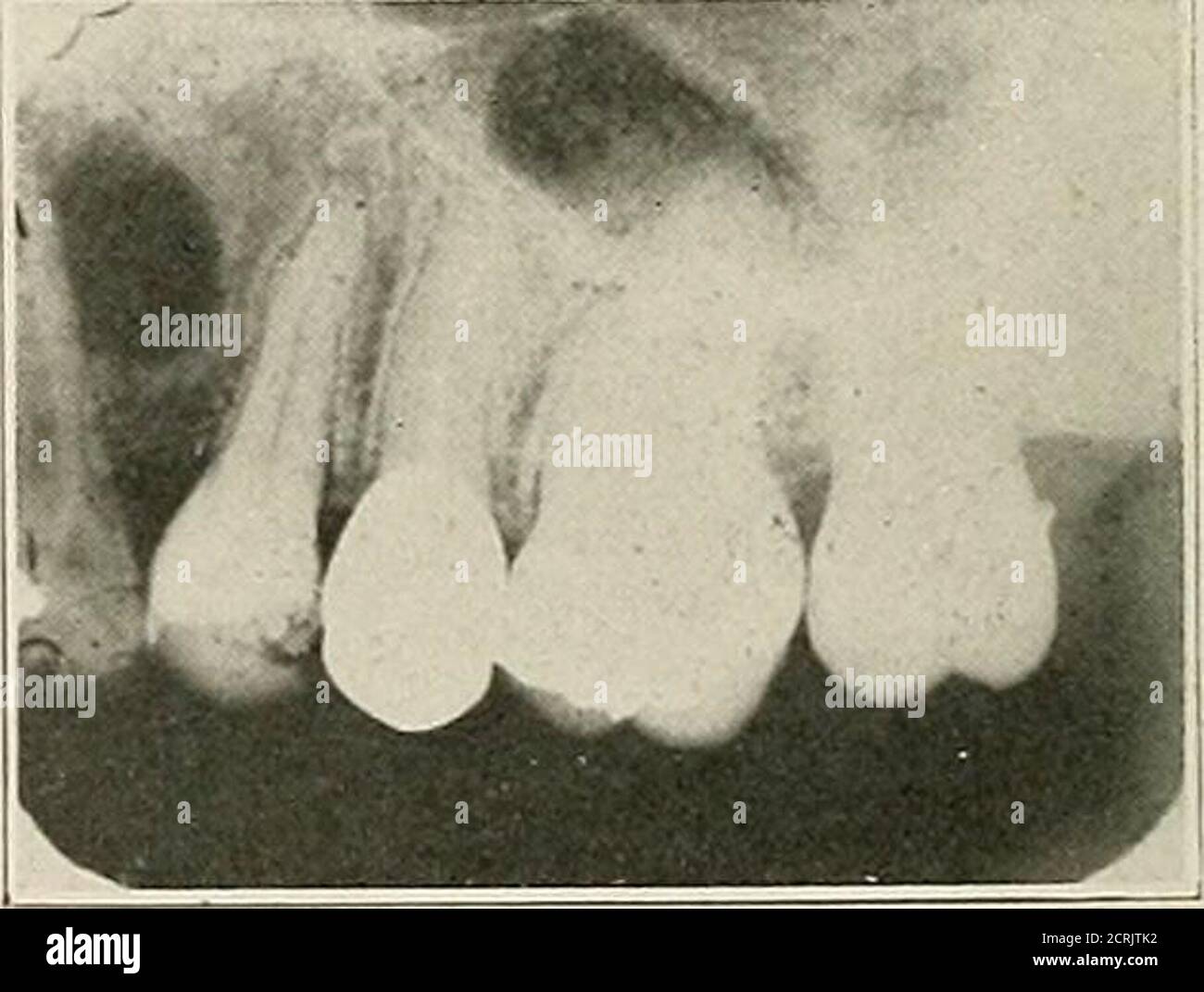 . Interpretation of dental and maxillary roentgenograms . Fig. 116. Fig ...
