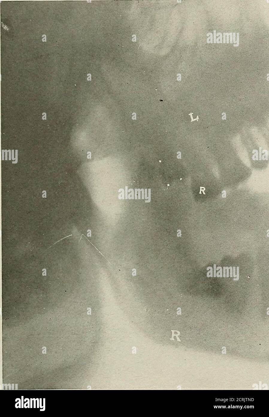 Skiagraphy hi-res stock photography and images - Alamy