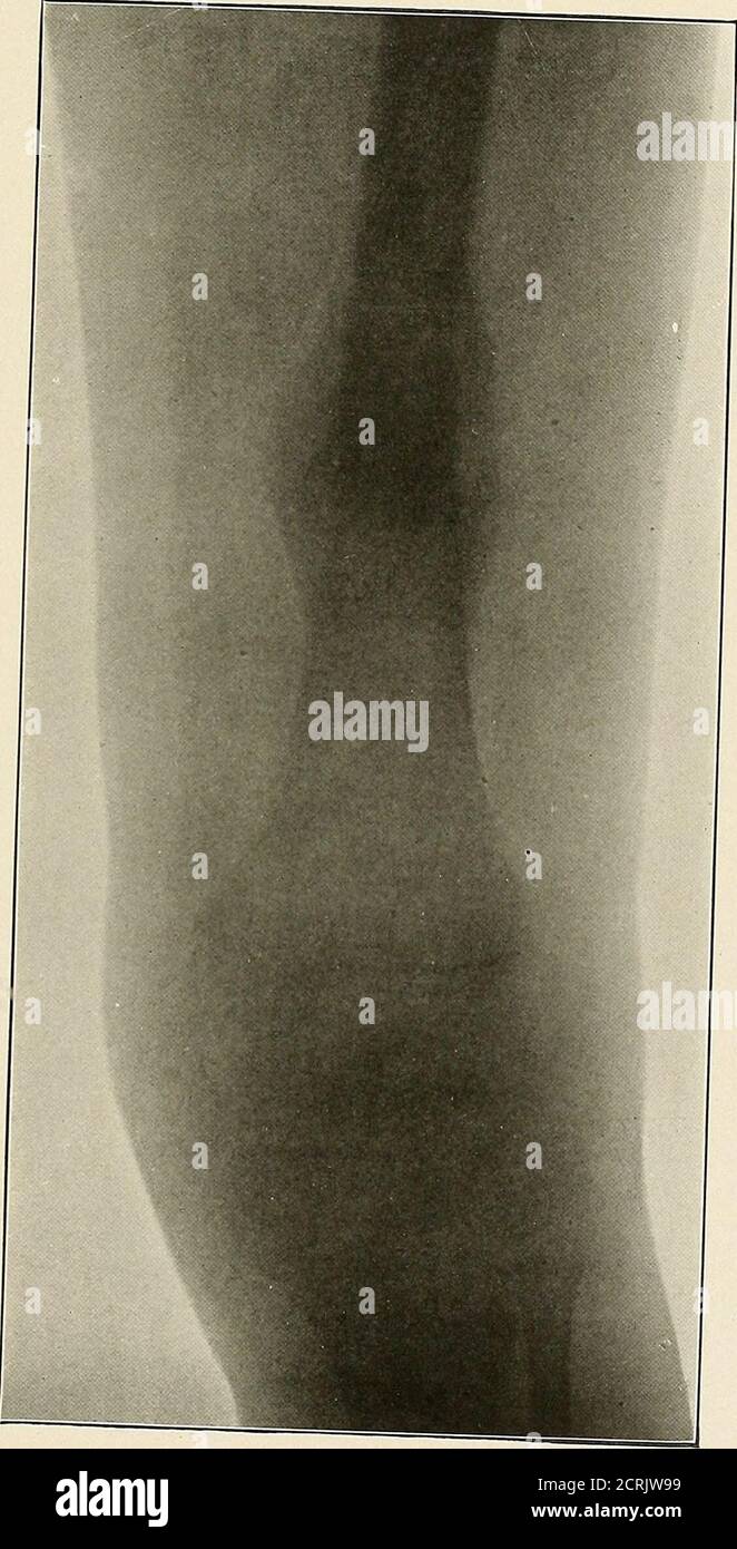 . A radiographic atlas of the pathologic changes of bones and joints ...