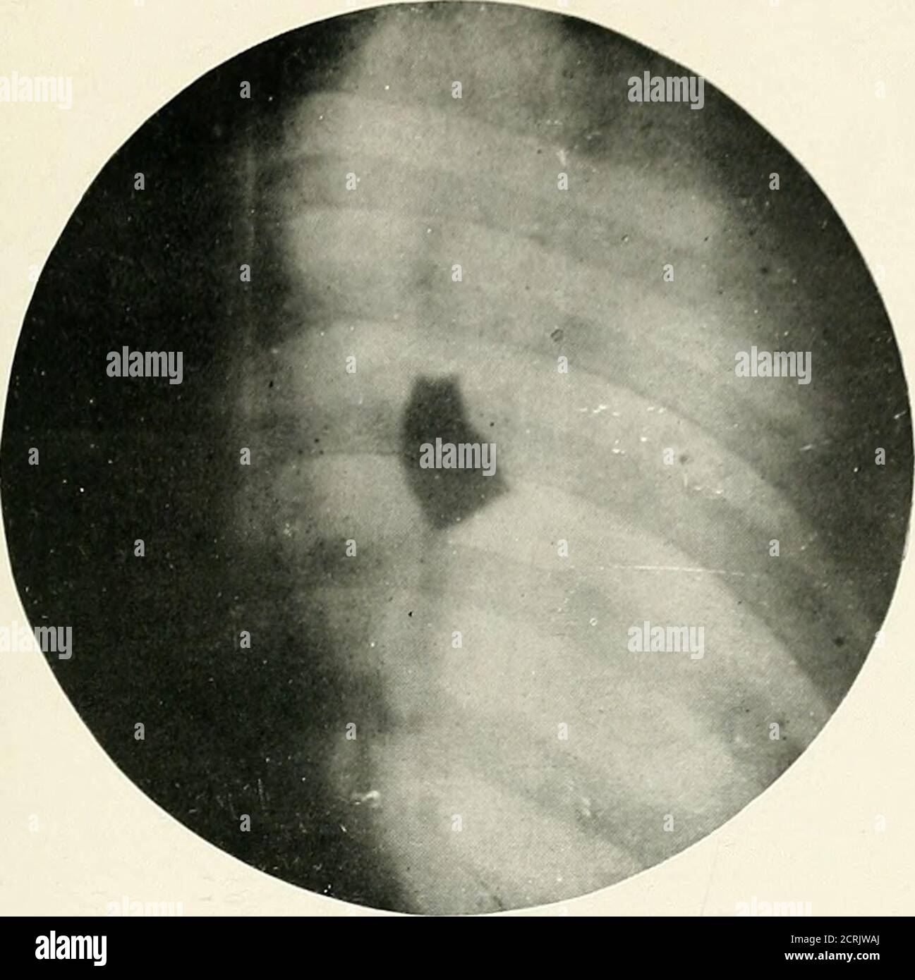 . Radio-diagnosis of pleuro-pulmonary affection . h does not evenhave ...