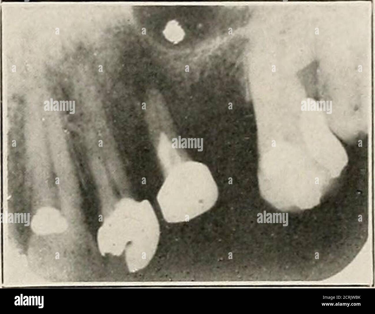 . Interpretation of dental and maxillary roentgenograms . Fig. 110. Fig ...