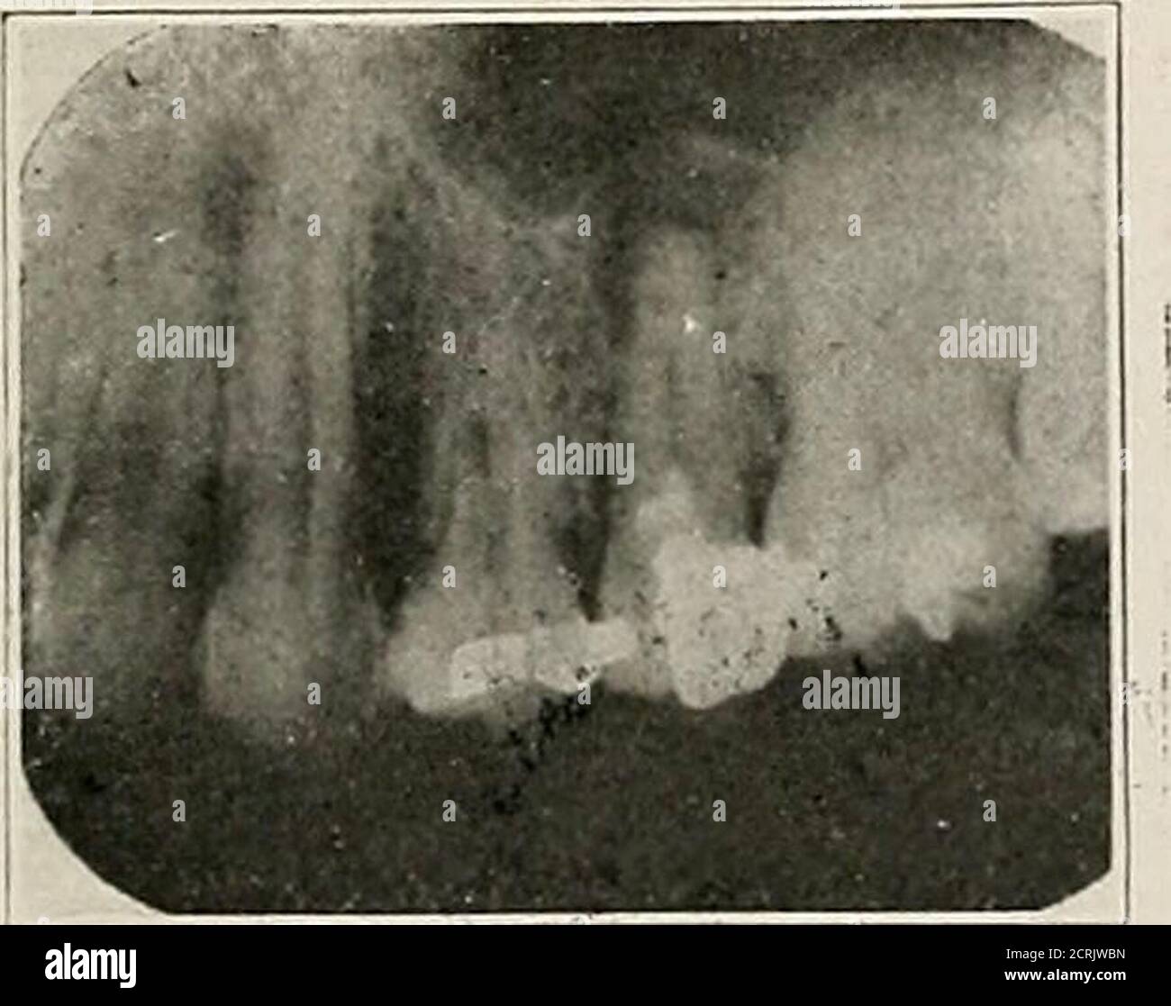 . Interpretation of dental and maxillary roentgenograms . Fig. 110. Fig ...