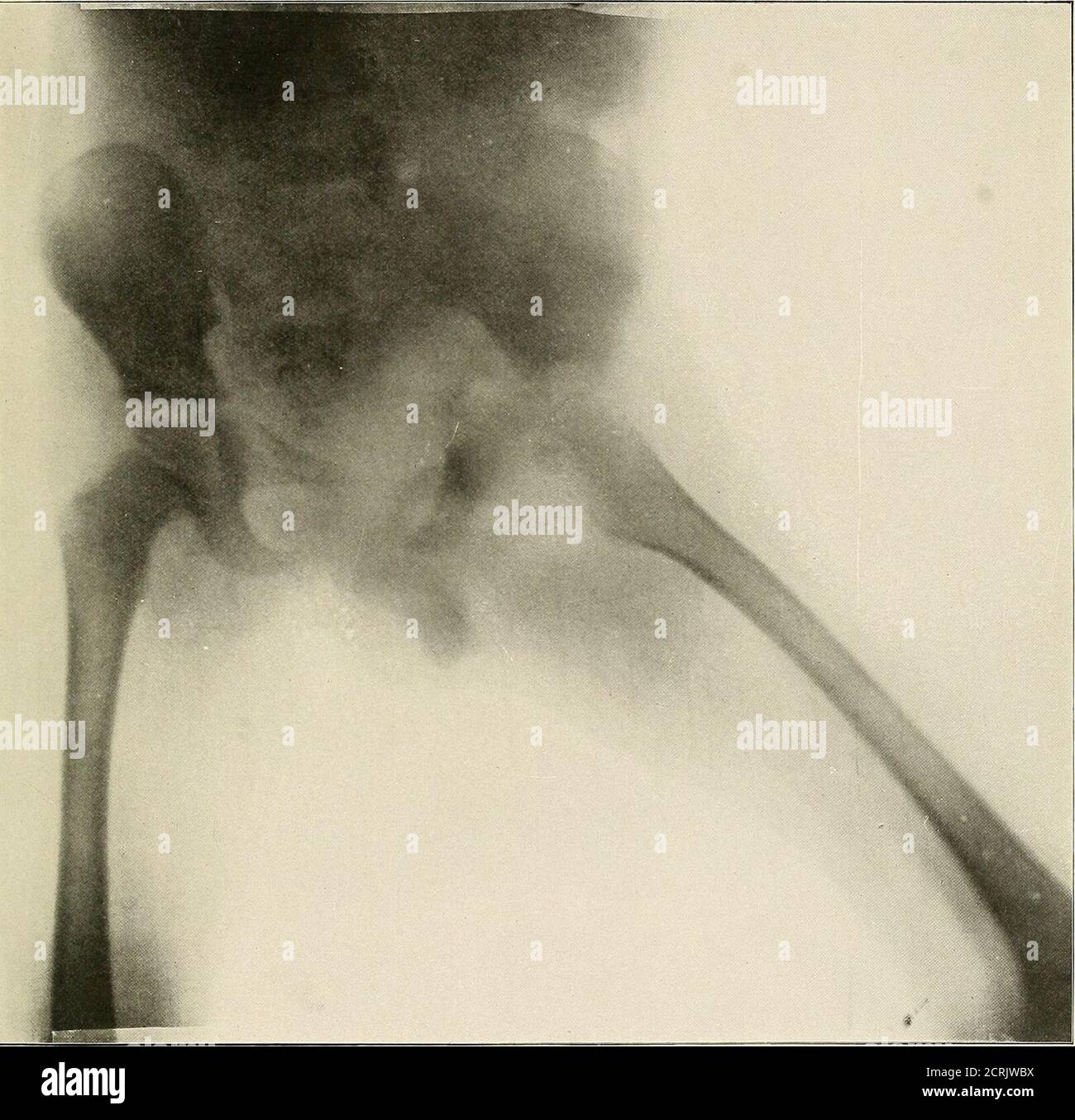 . A radiographic atlas of the pathologic changes of bones and joints ...