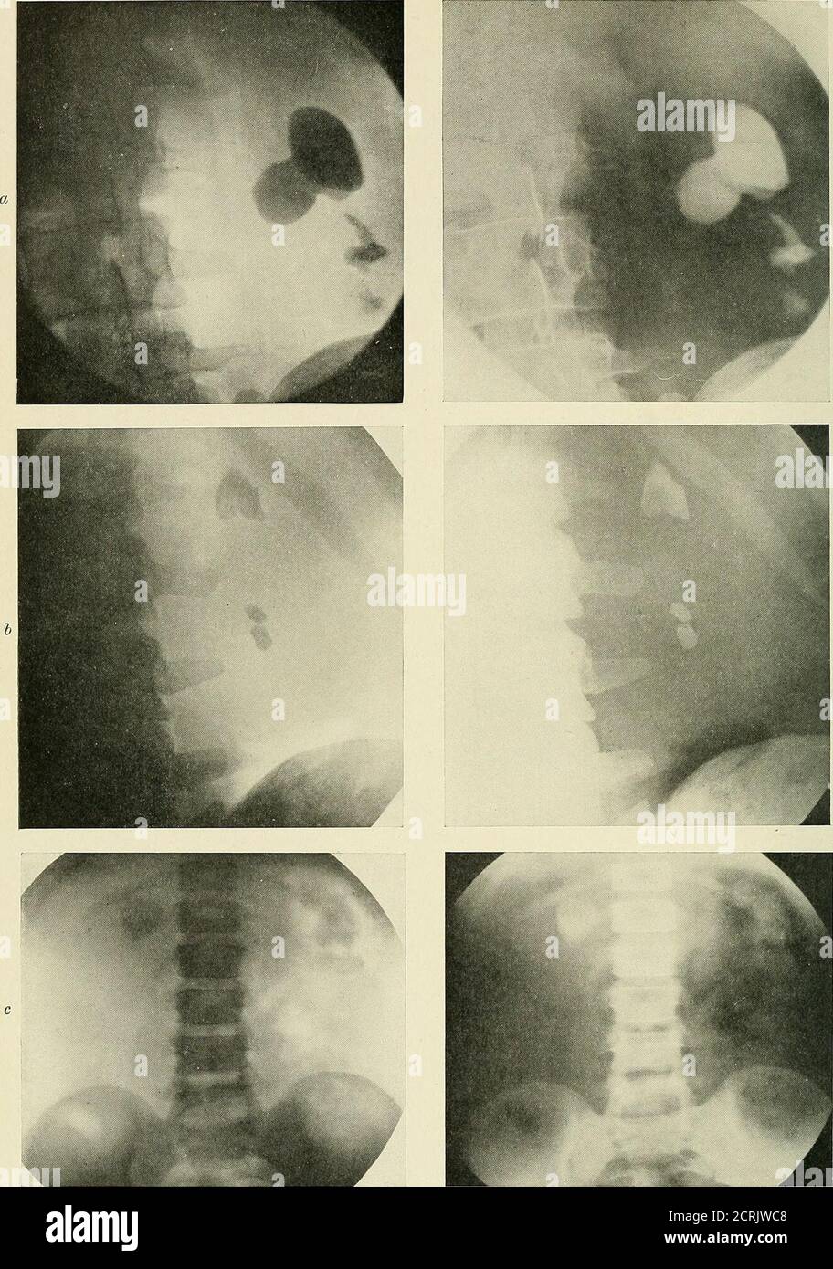 Calices renales hi-res stock photography and images - Alamy