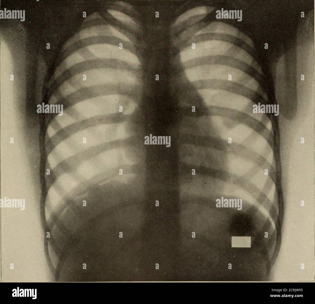 . Living anatomy and pathology; . PLATE 108.NORMAL THORAX. Girl, age 7 ...