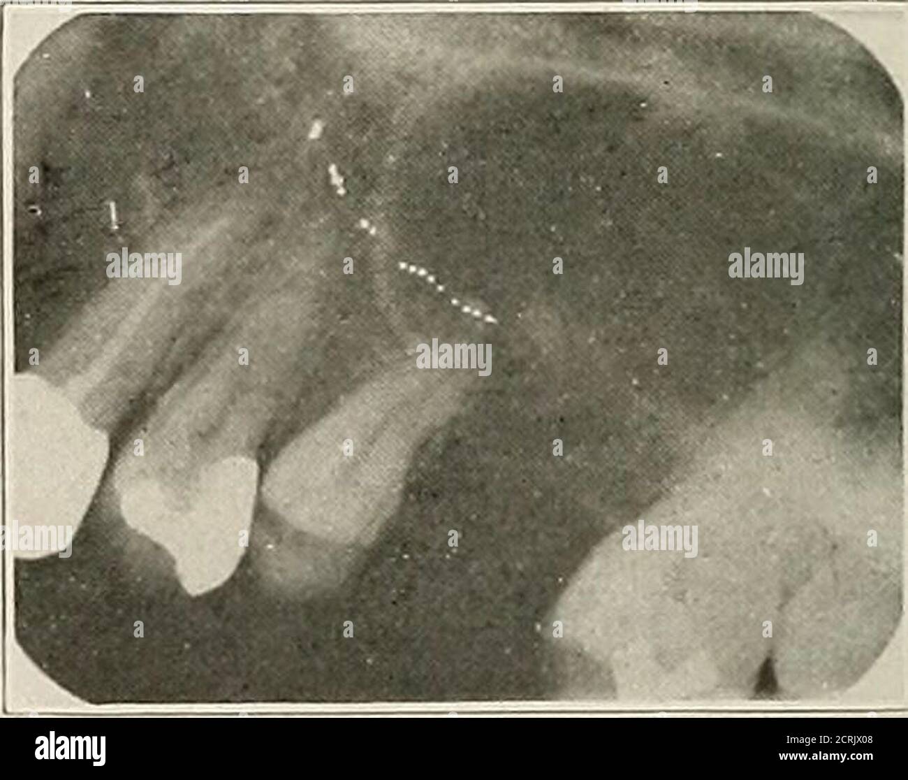 . Interpretation of dental and maxillary roentgenograms . Fig. 1( Fig ...