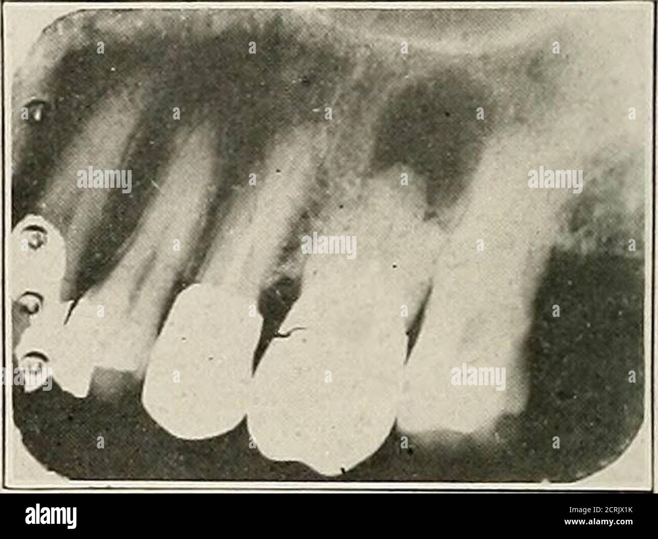 Maxillary first premolar hi-res stock photography and images - Alamy