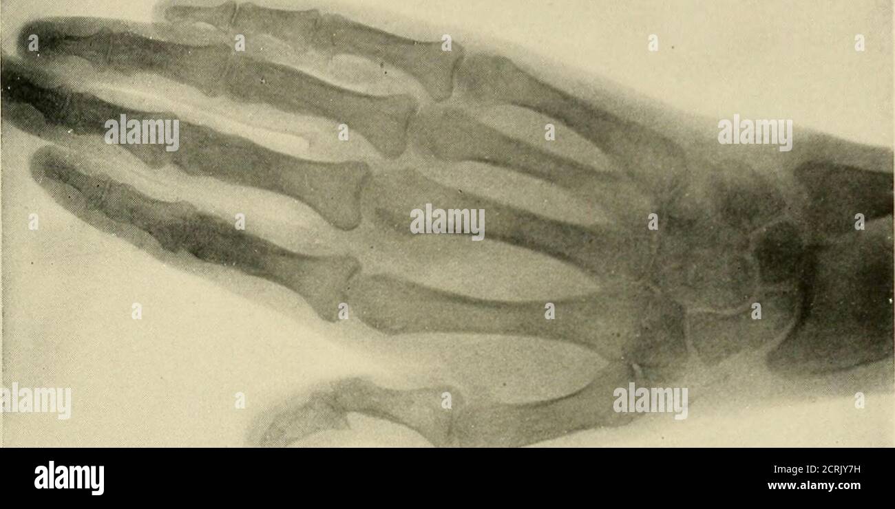 Osteoperiostitis hi-res stock photography and images - Alamy