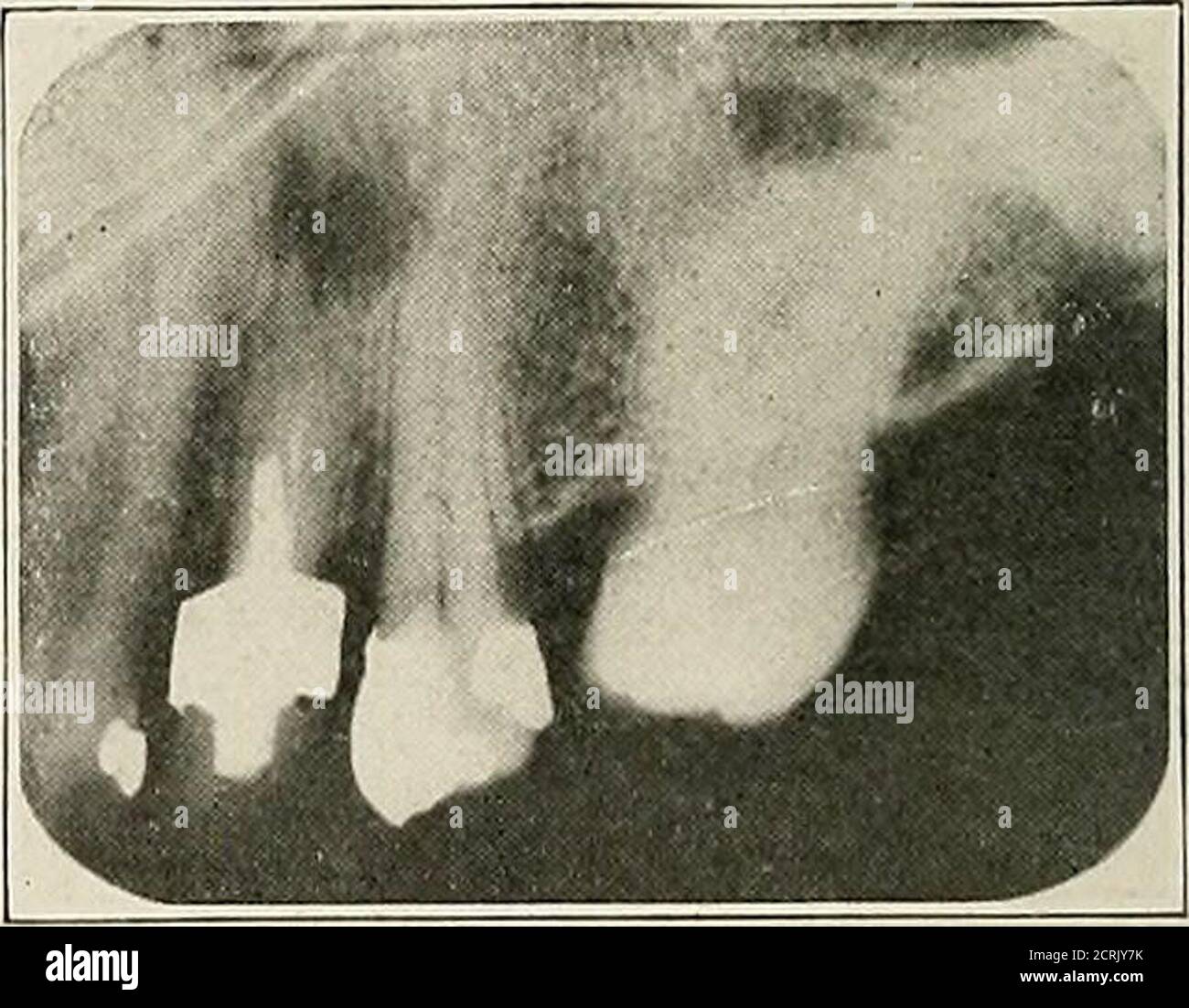 . Interpretation of dental and maxillary roentgenograms . Fig. 100. Fig ...