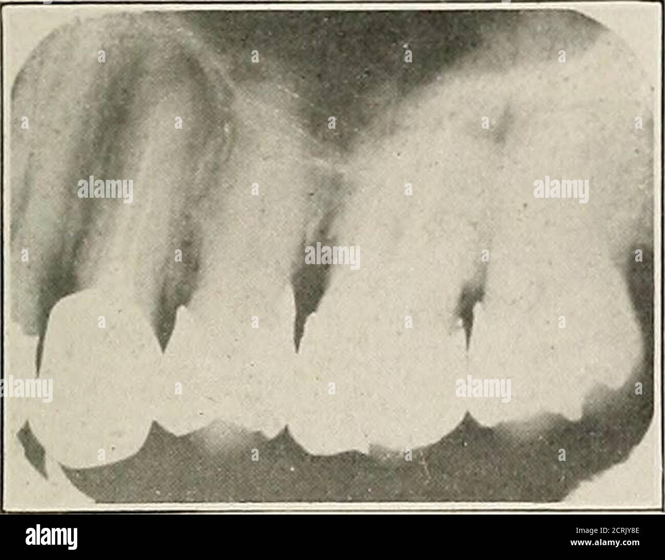 . Interpretation of dental and maxillary roentgenograms . Fig. 100. Fig ...