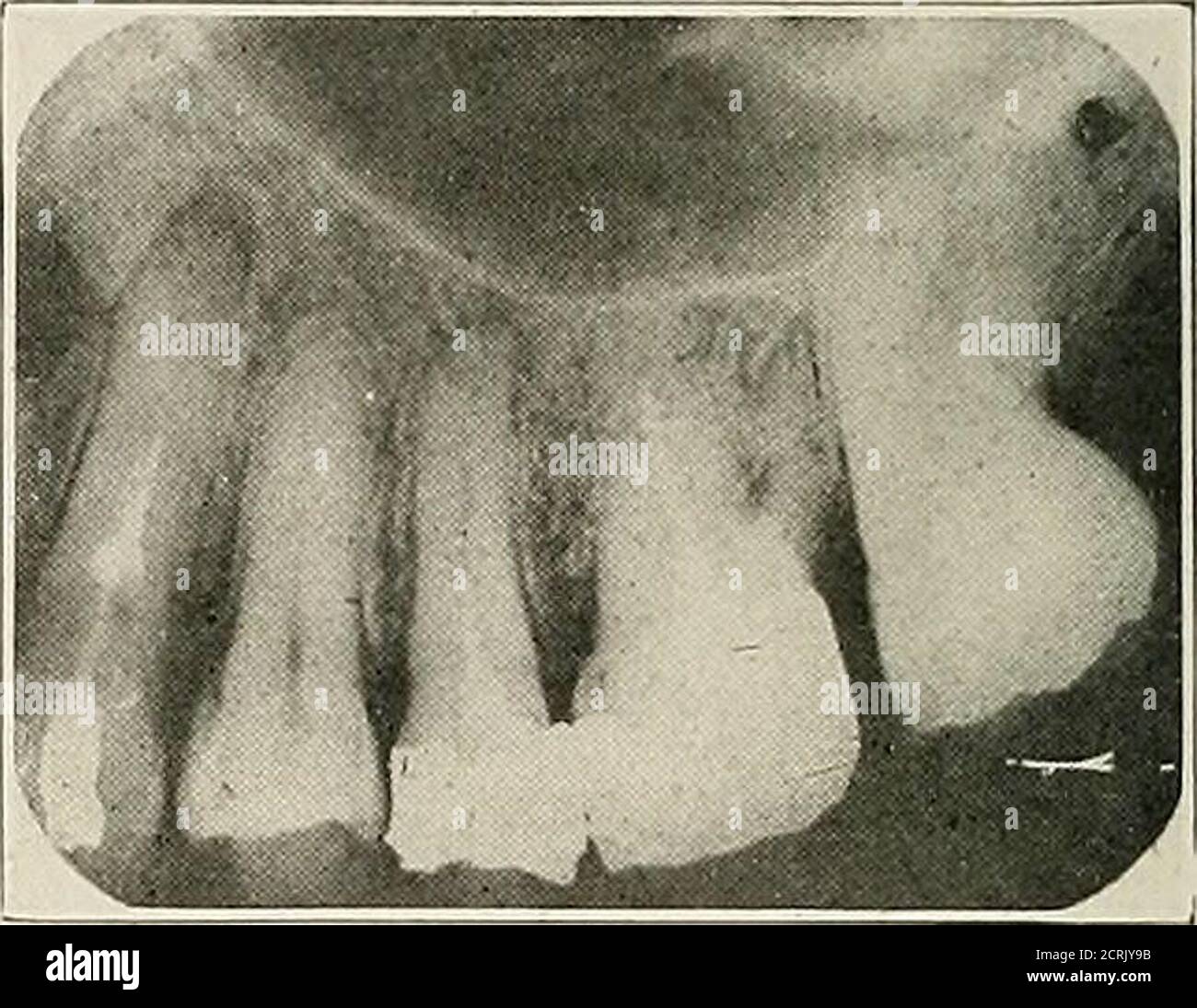 . Interpretation of dental and maxillary roentgenograms . Fig. 98. Fig ...