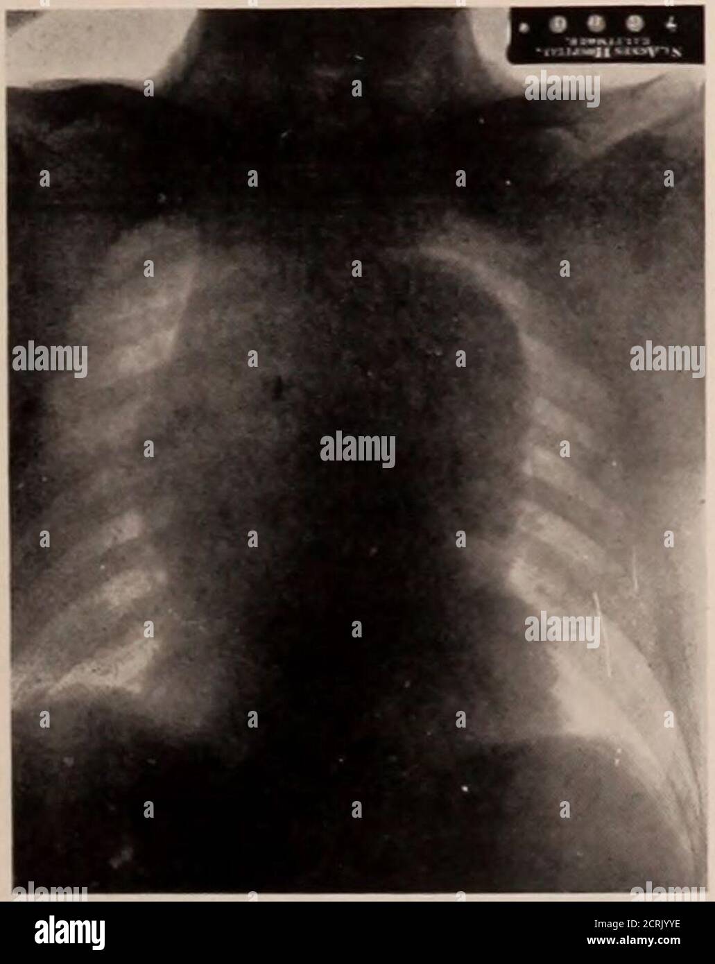 Dermoid cyst hi-res stock photography and images - Alamy
