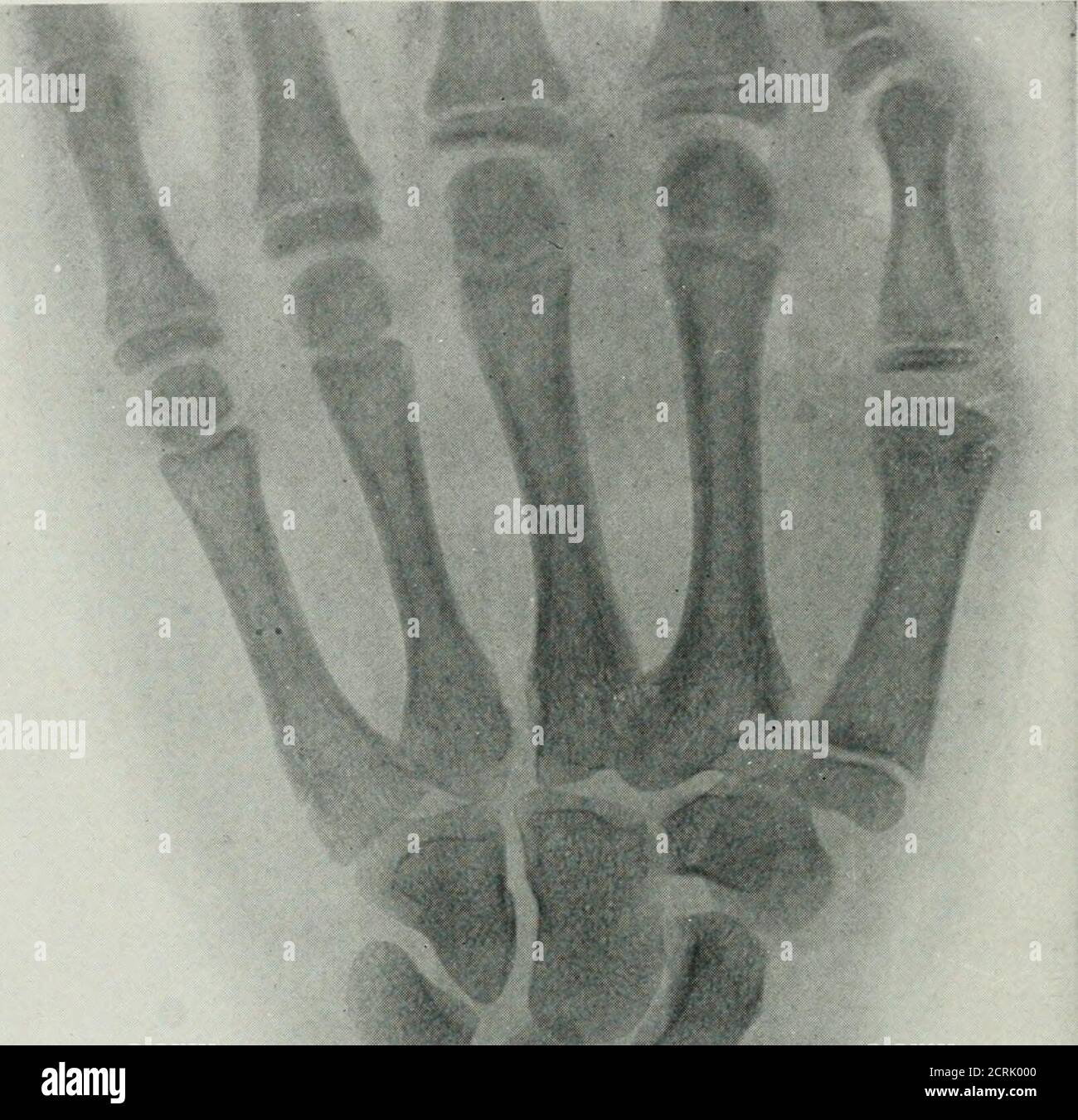 . The Roentgen rays in medicine and surgery as an aid in diagnosis and ...
