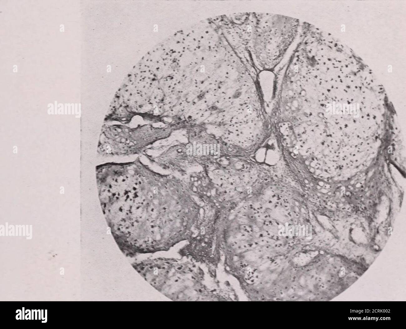 . Journal of radiology . Fig. 19.—Case VI. X-ray showingfibular graft ...