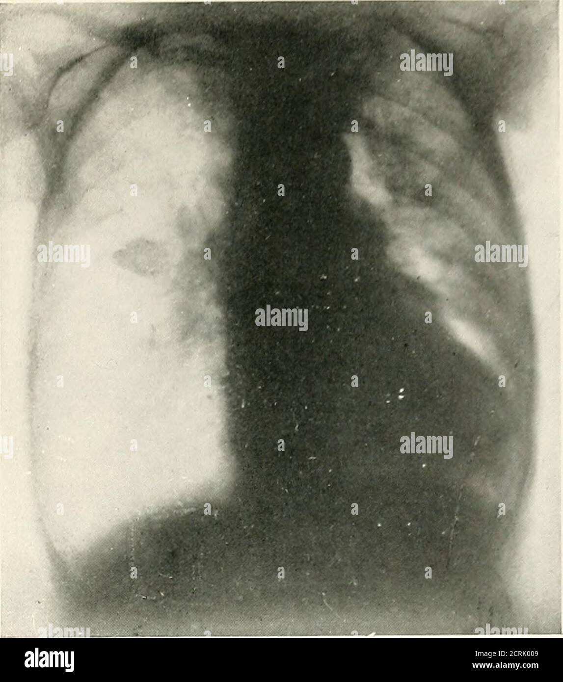 . Radio-diagnosis of pleuro-pulmonary affection . FiG. 26Secondary ...