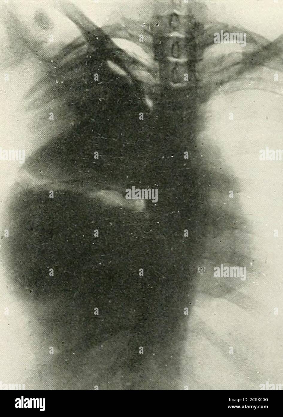 . Radio-diagnosis of pleuro-pulmonary affection . Radiograph 42 ...