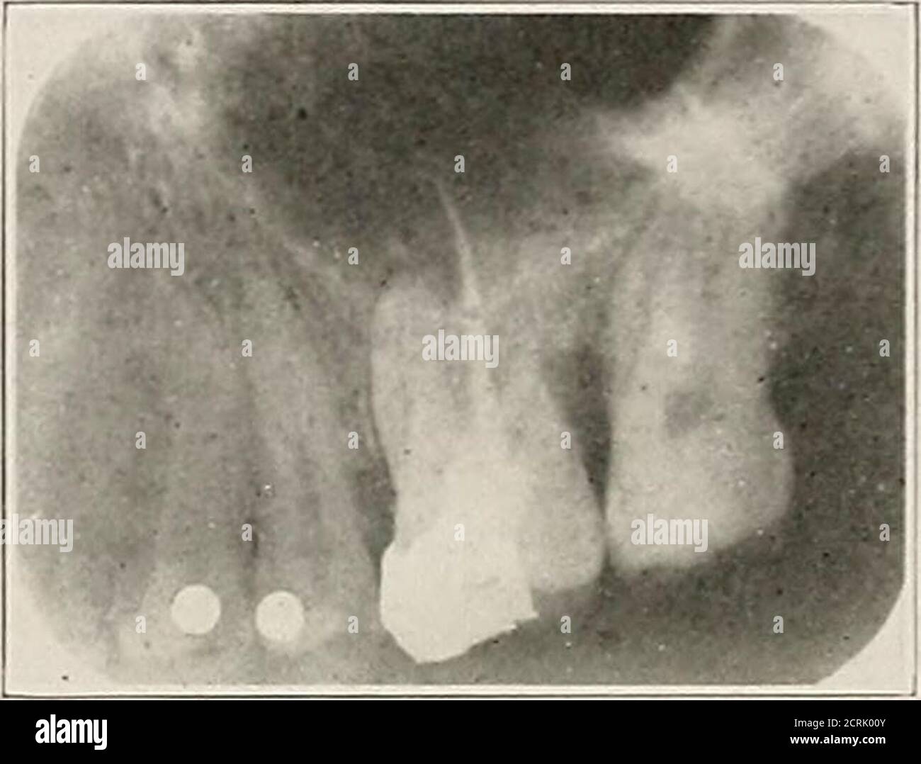 . Interpretation of dental and maxillary roentgenograms . Fig. 94. Fig ...