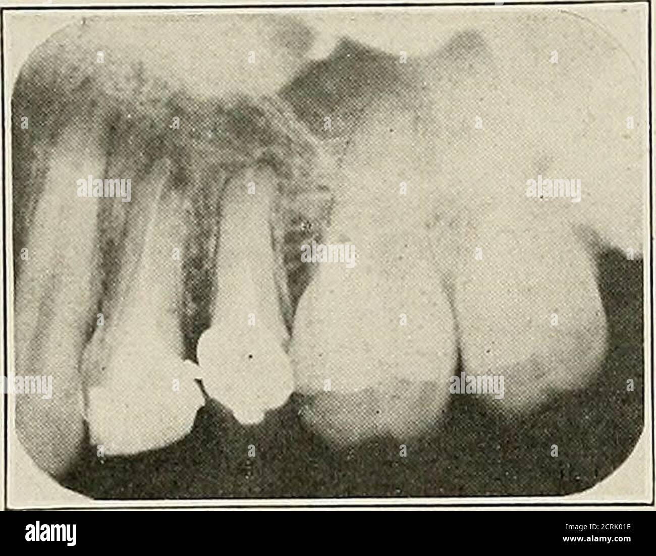 . Interpretation of dental and maxillary roentgenograms . Fig. 96. Fig ...