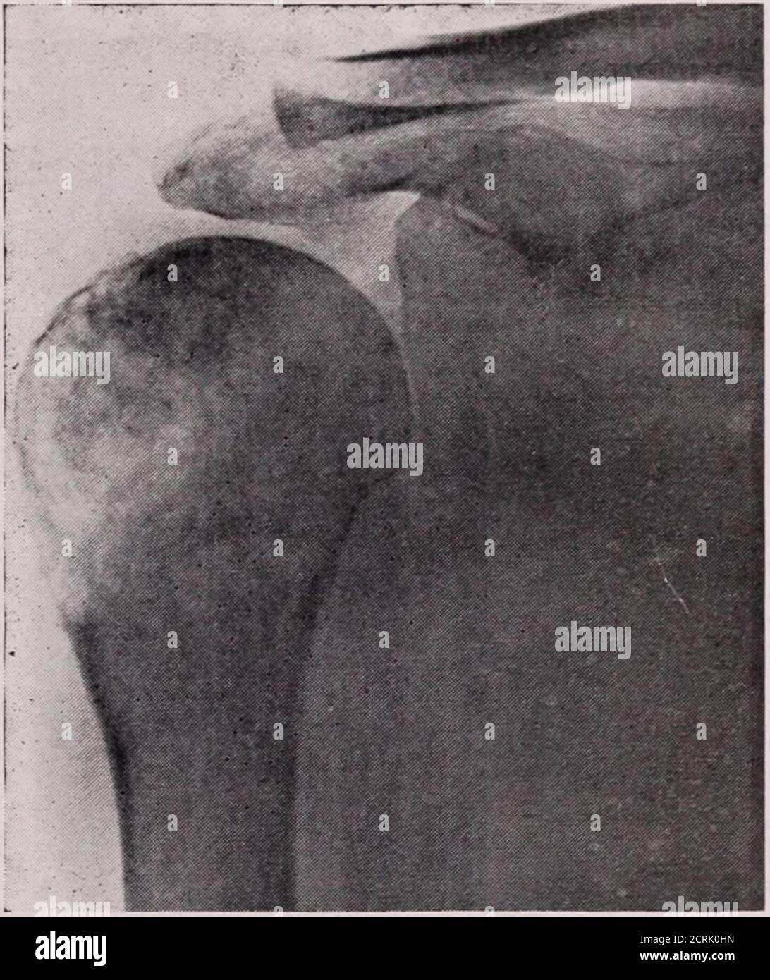 Abduction of shoulder joint hi-res stock photography and images - Alamy