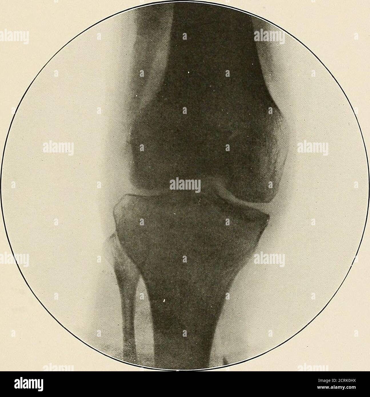 . A radiographic atlas of the pathologic changes of bones and joints ...