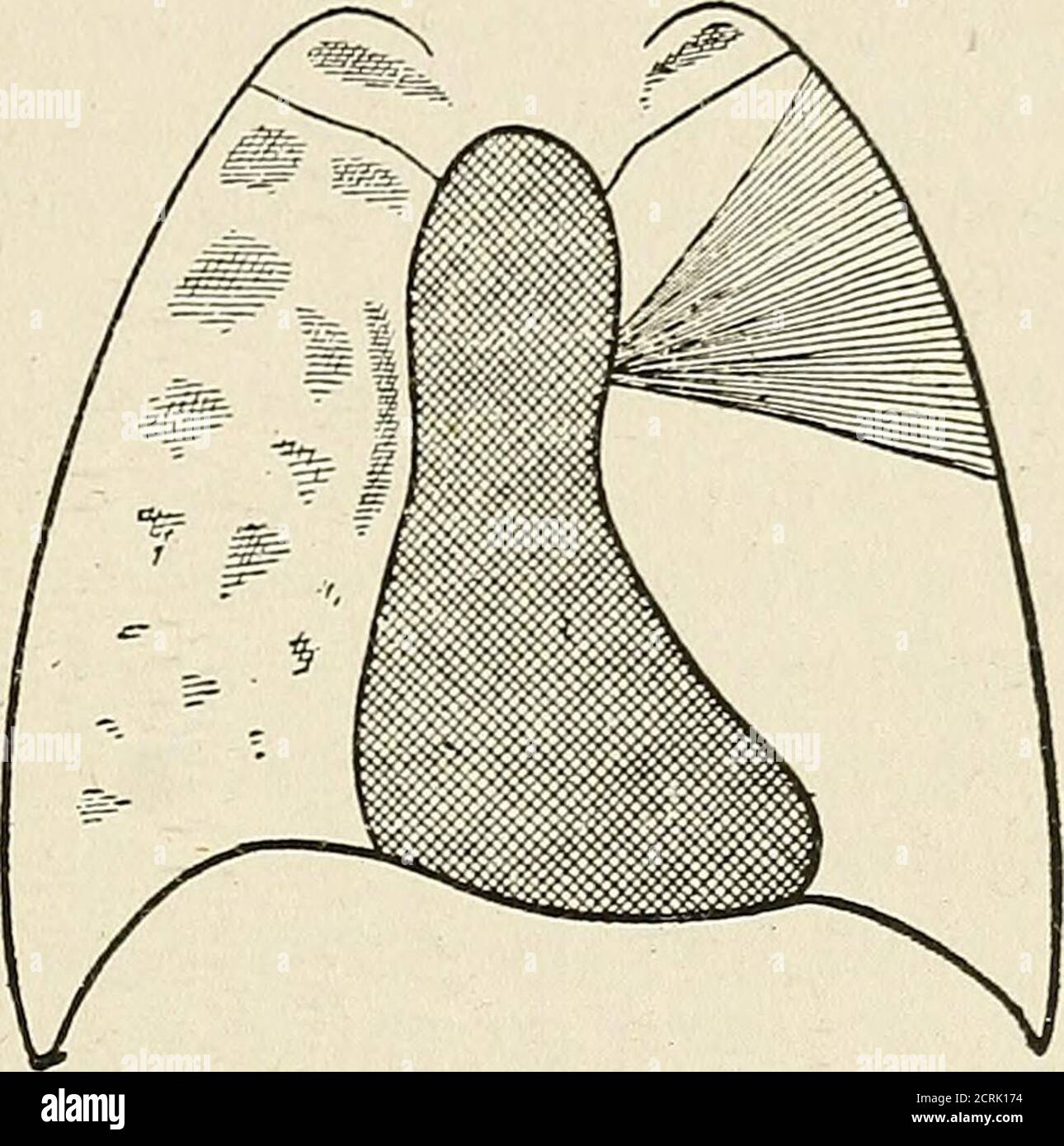. Radio-diagnosis of pleuro-pulmonary affection . appear, disappear ...