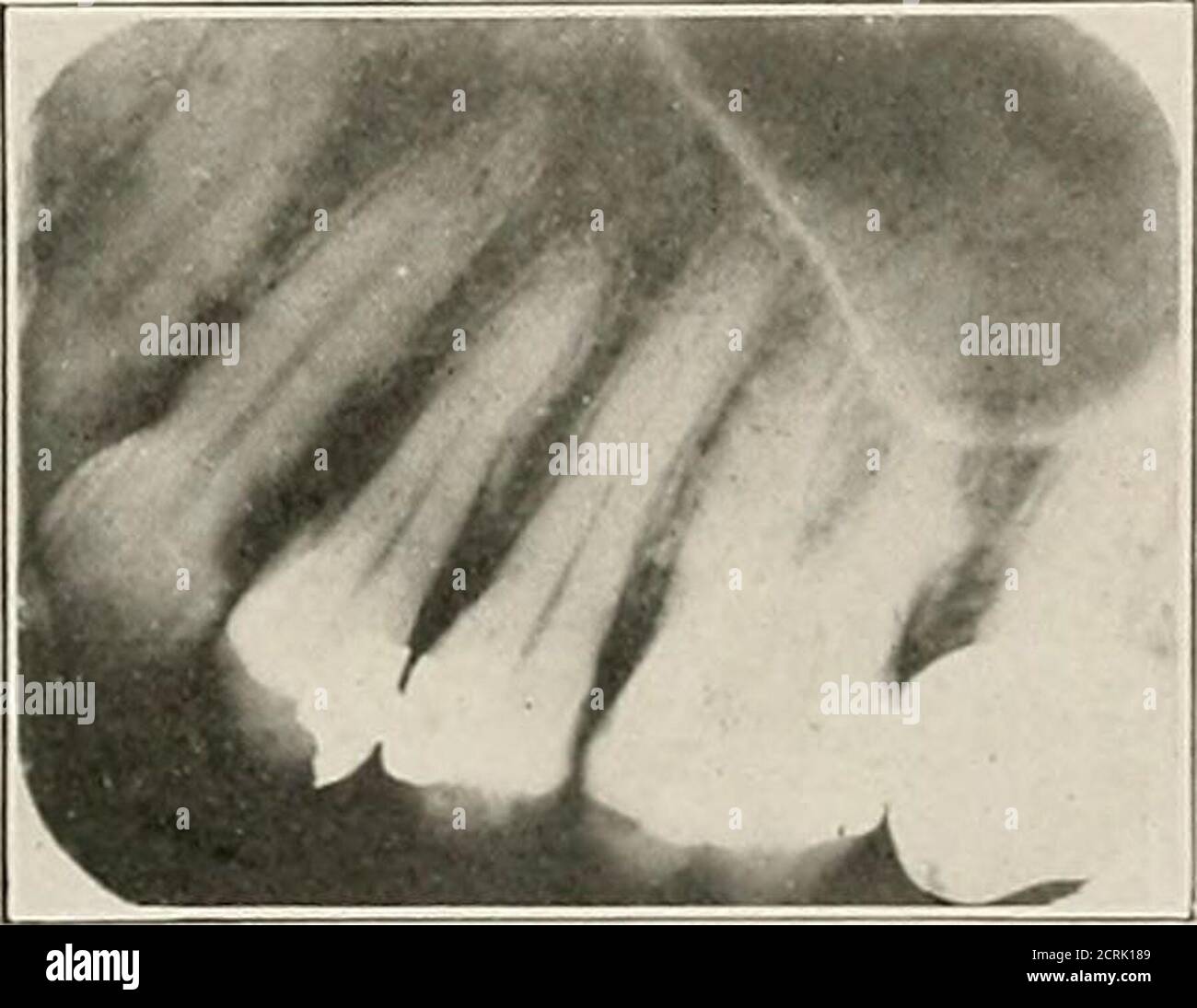 . Interpretation of dental and maxillary roentgenograms . Fig. 88. Fig ...