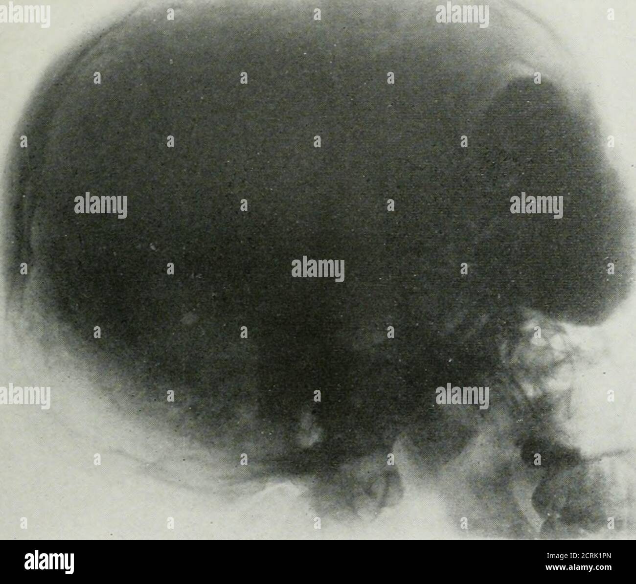 Sphenoidal sinuses hi-res stock photography and images - Alamy