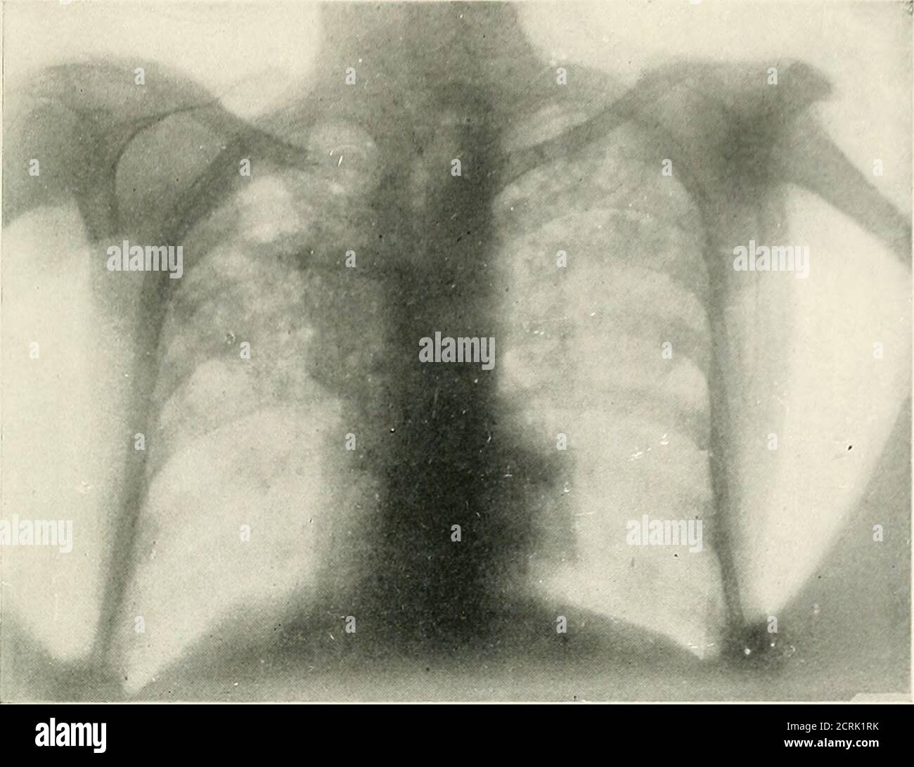 Lung Abscess High Resolution Stock Photography and Images - Alamy