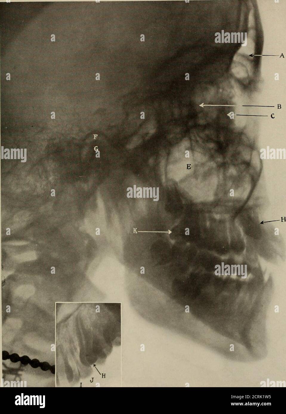 Inferior maxillary bone hi-res stock photography and images - Alamy