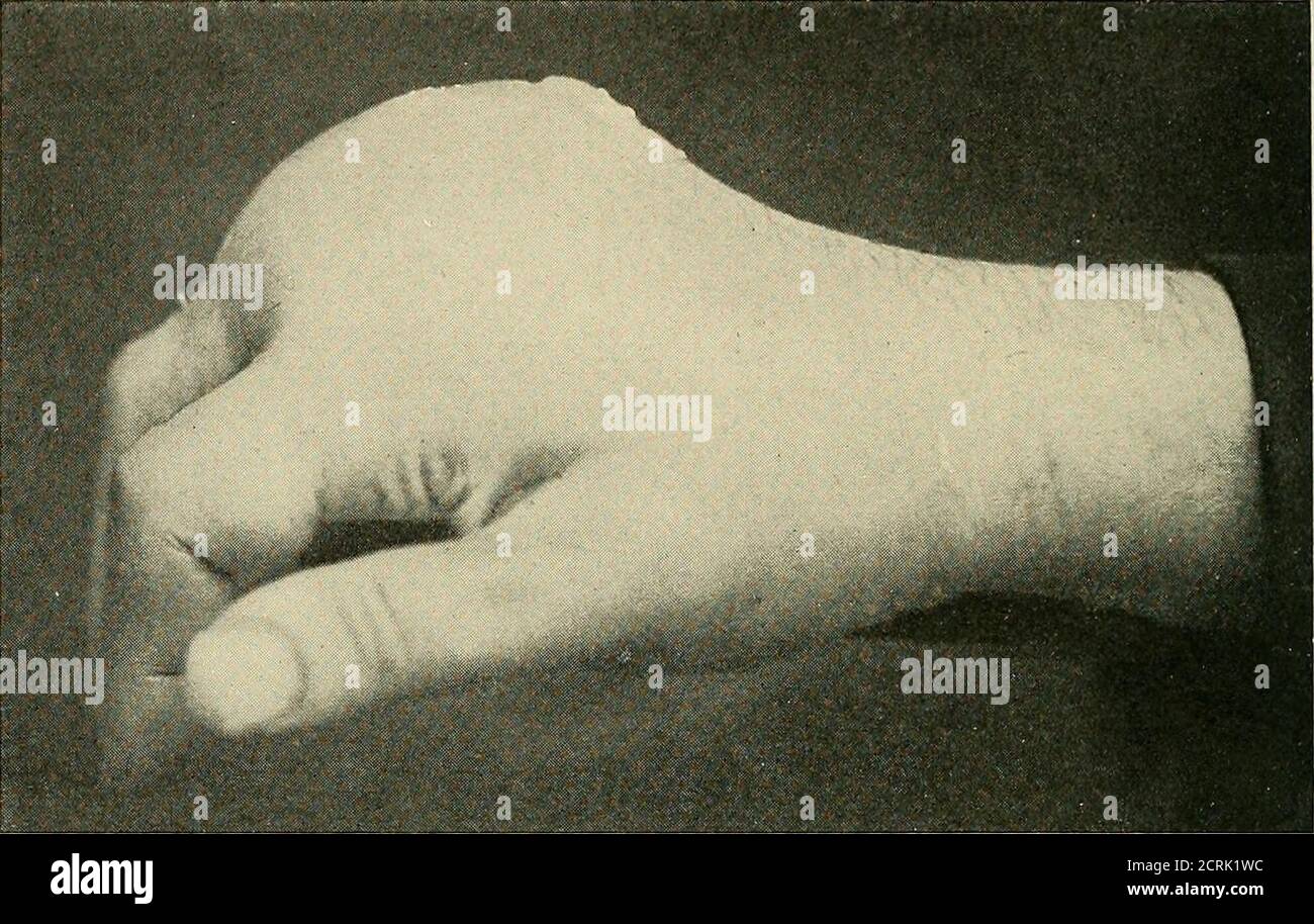 Granulation tissues hi-res stock photography and images - Alamy