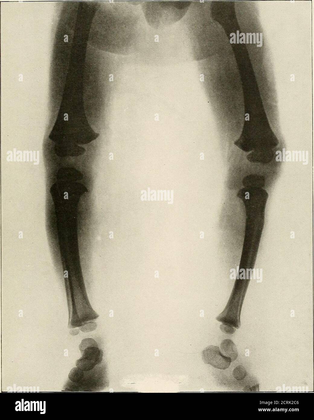 . A radiographic atlas of the pathologic changes of bones and joints ...