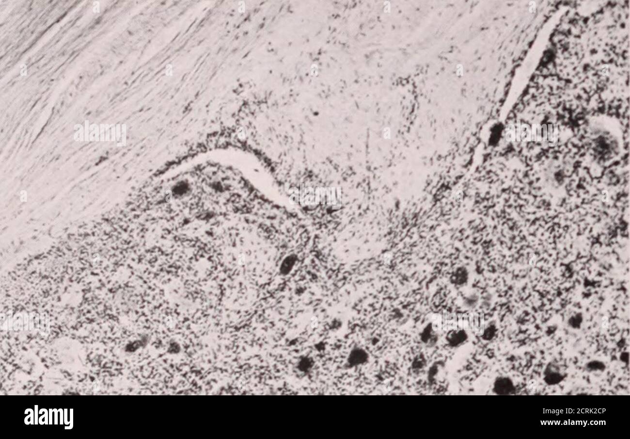 Primary bone tumor hi-res stock photography and images - Alamy