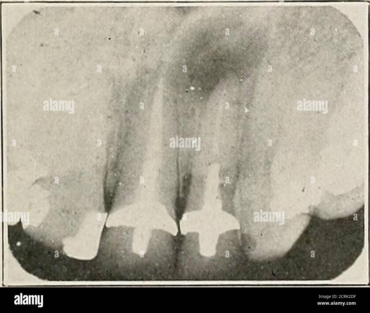. Interpretation of dental and maxillary roentgenograms . Fig. 7S. Fig ...