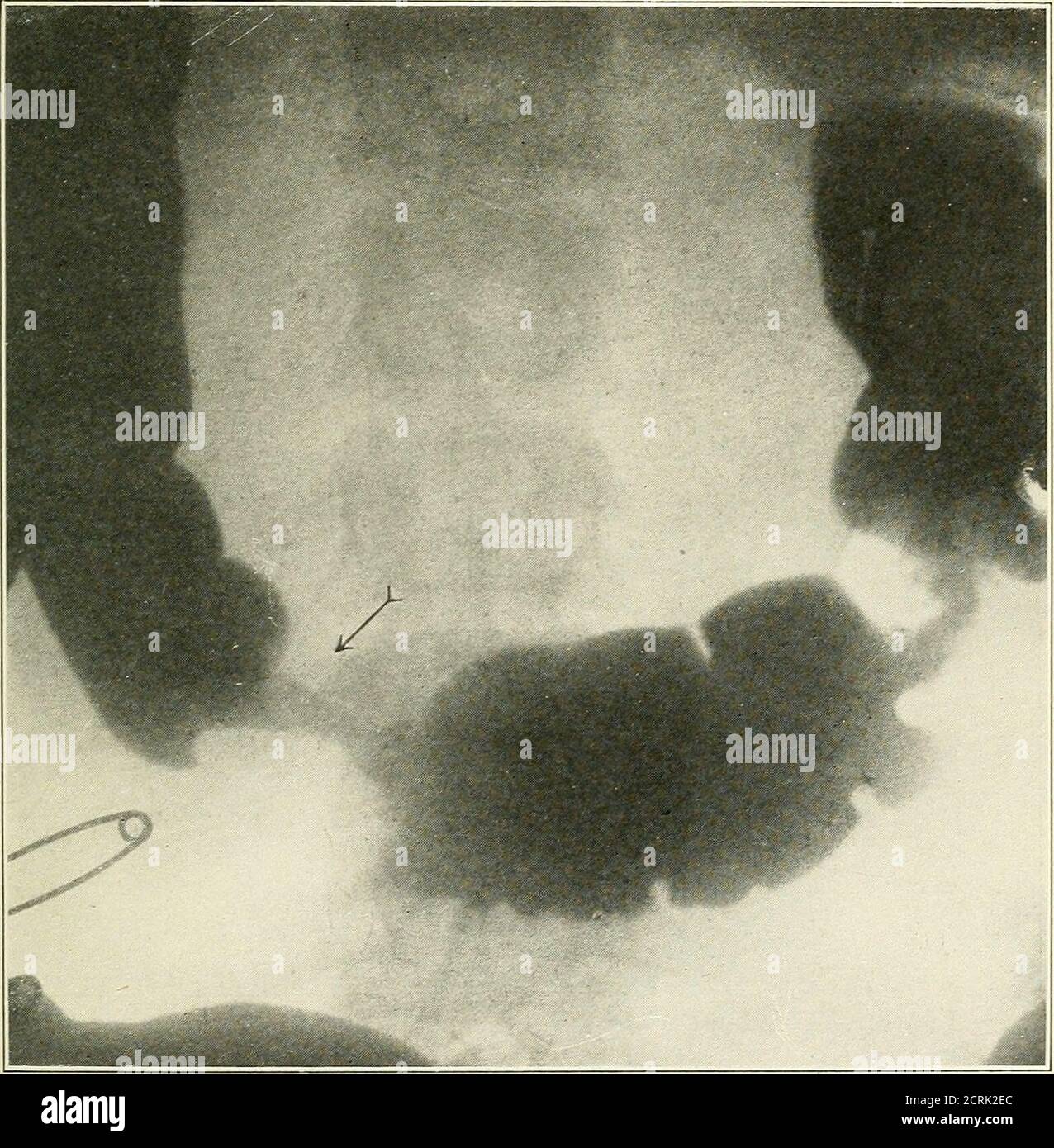 Distal colon hi-res stock photography and images - Alamy