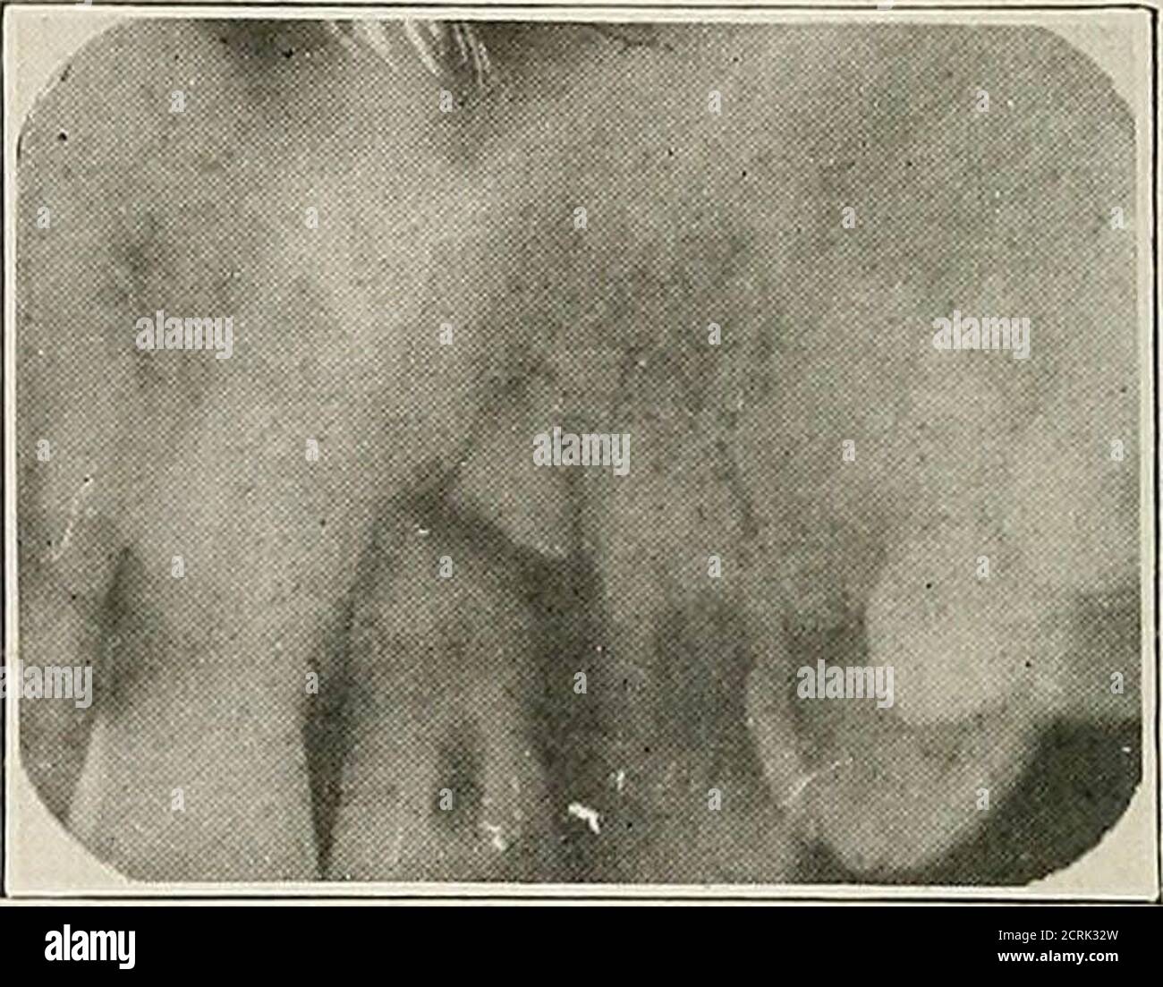 . Interpretation of dental and maxillary roentgenograms . Fig. 74. Fig ...