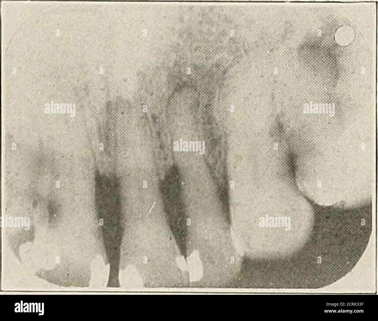 . Interpretation of dental and maxillary roentgenograms . Fig. 74. Fig ...