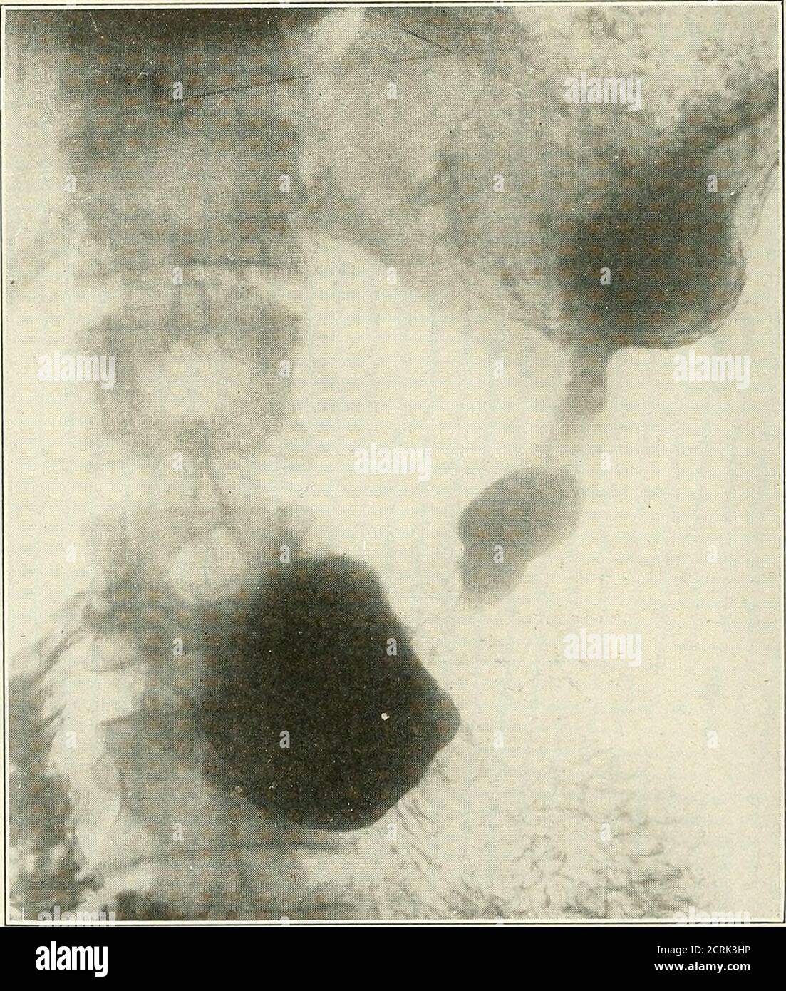 Linitis plastica hi-res stock photography and images - Alamy