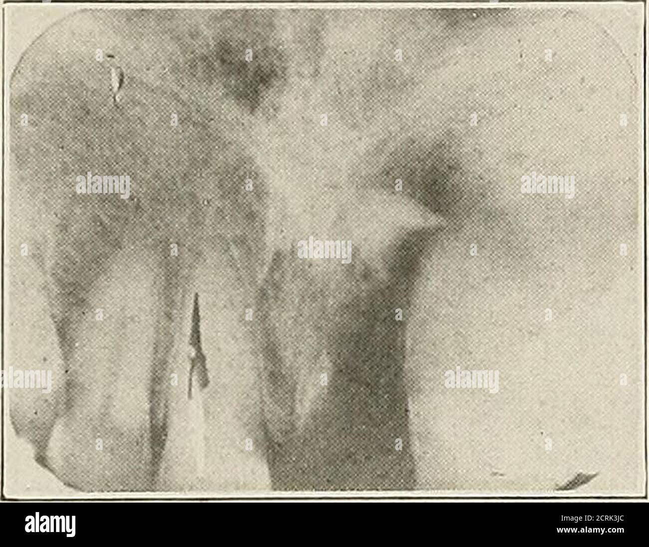 . Interpretation of dental and maxillary roentgenograms . Fig. 72. Fig ...