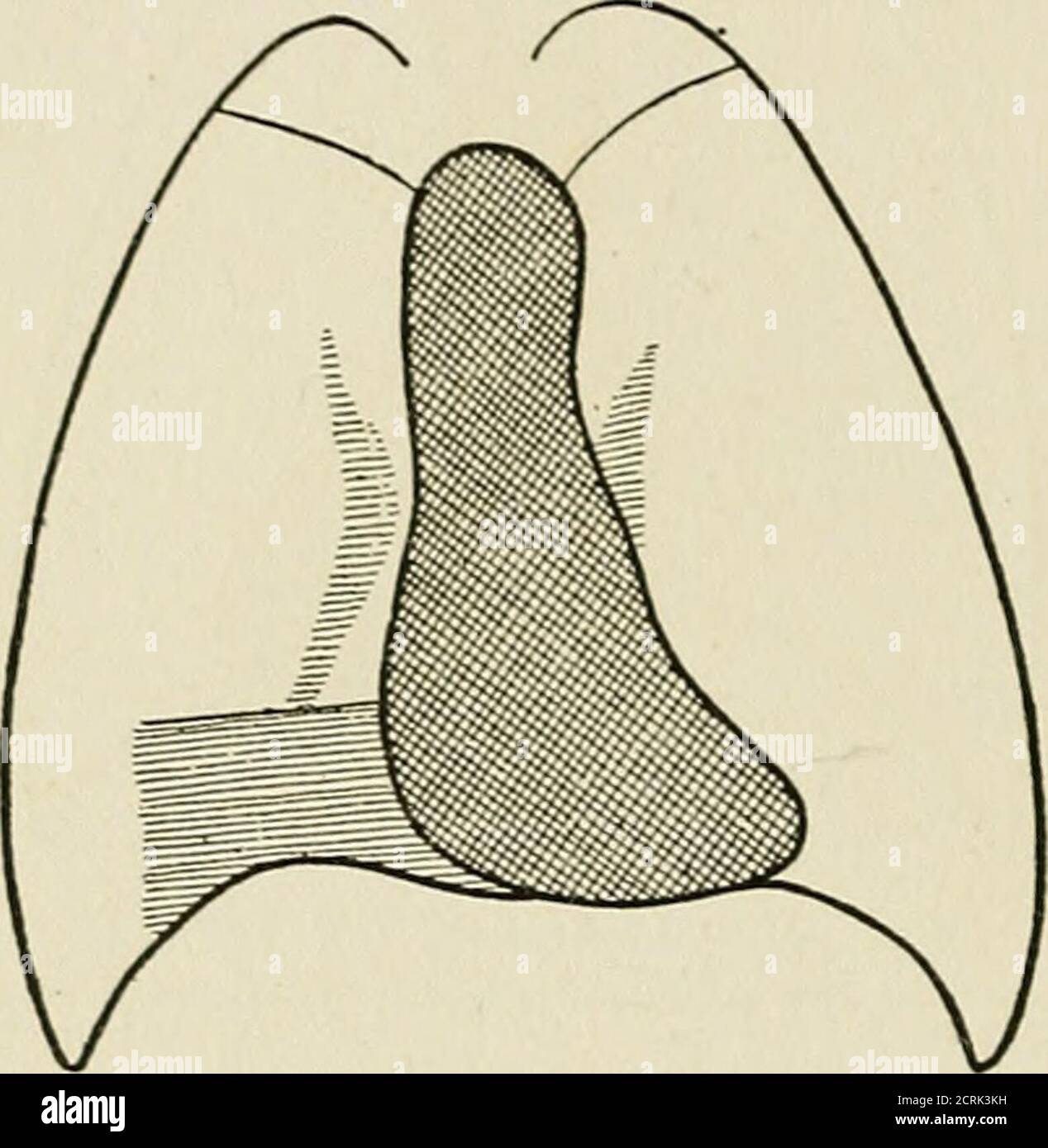 Abscess Incision High Resolution Stock Photography and Images - Alamy