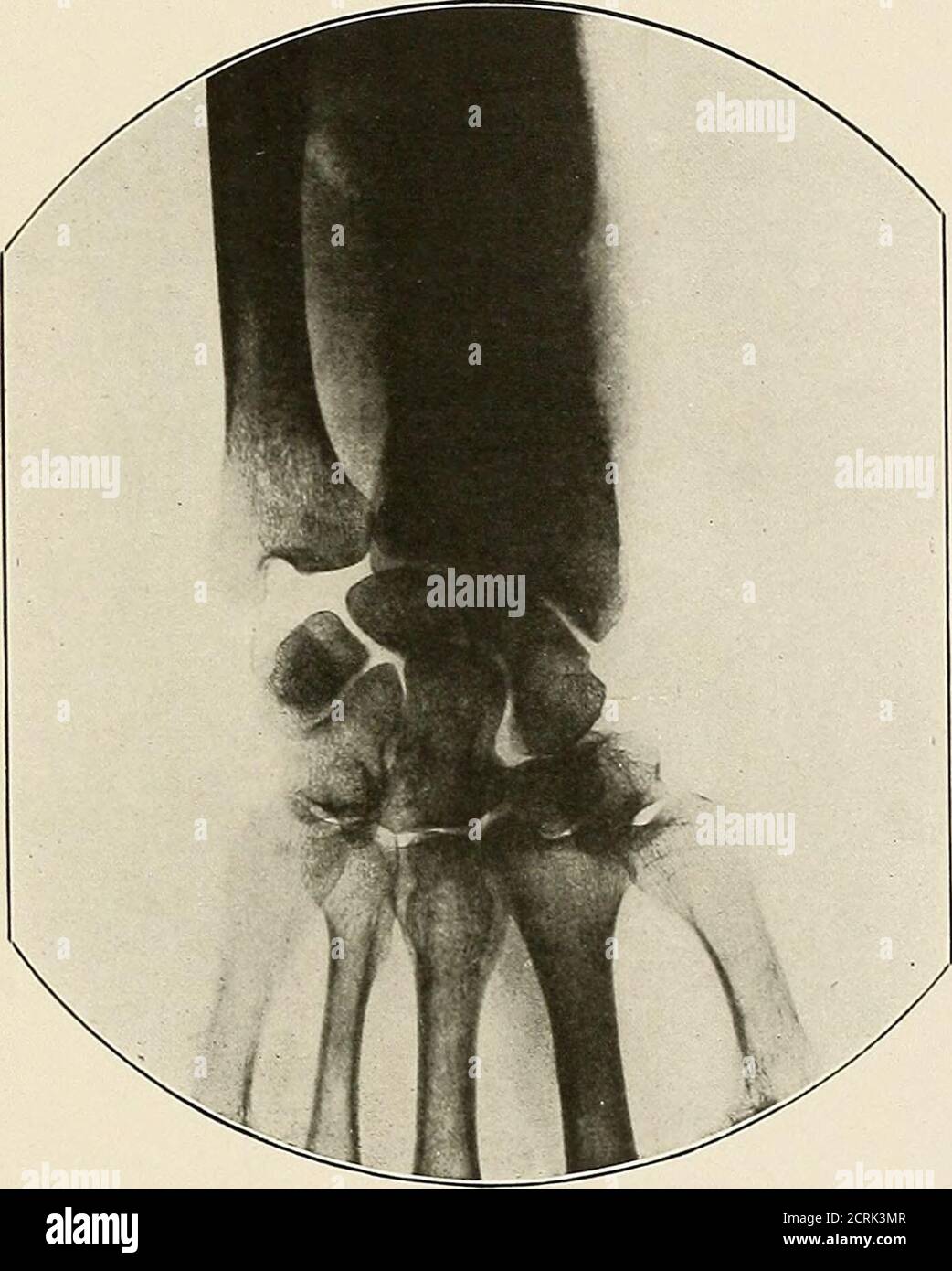 . A radiographic atlas of the pathologic changes of bones and joints ...