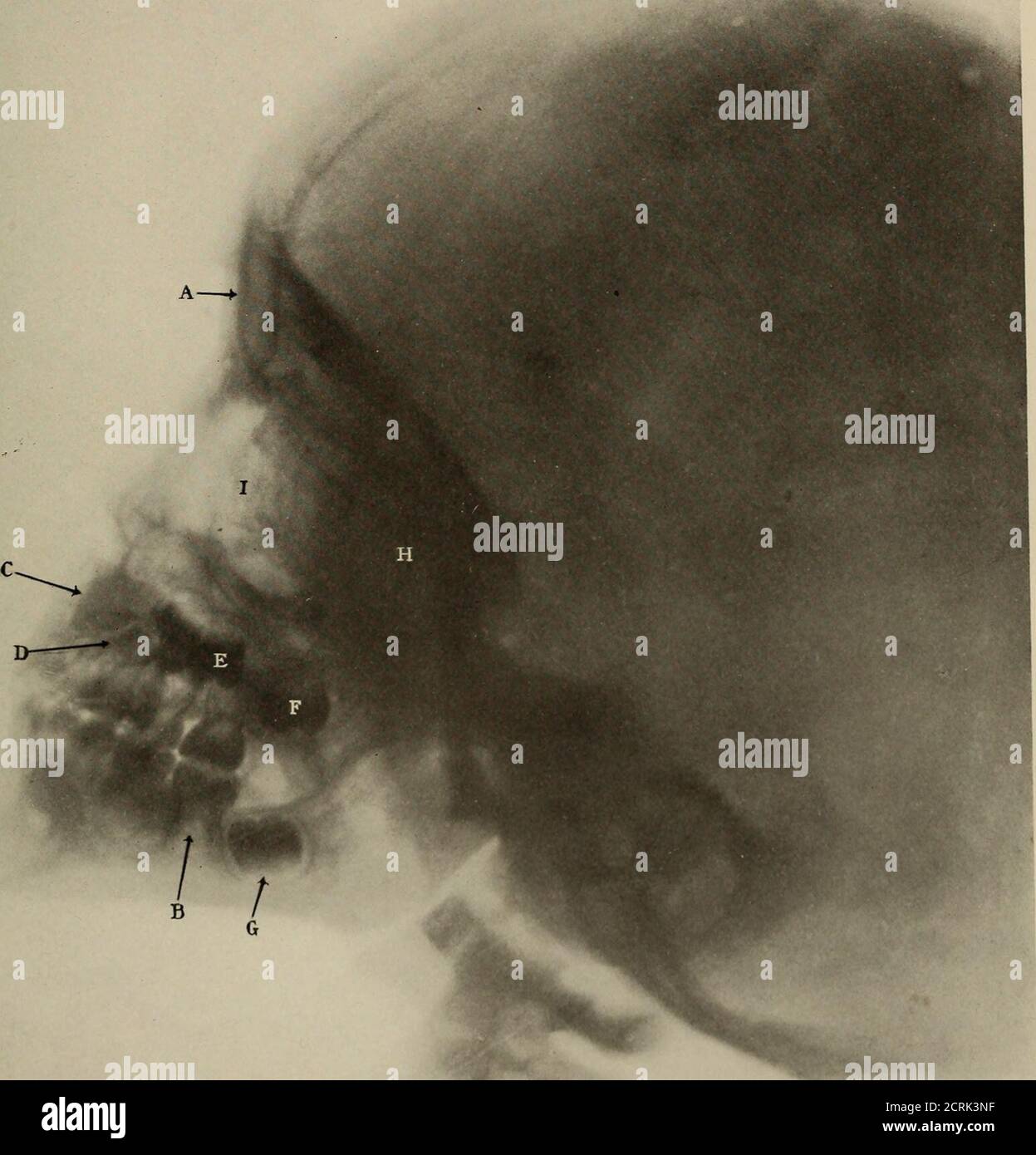 . Living anatomy and pathology; . r PLATE 91.ETHMOIDITIS. Age 3 years ...