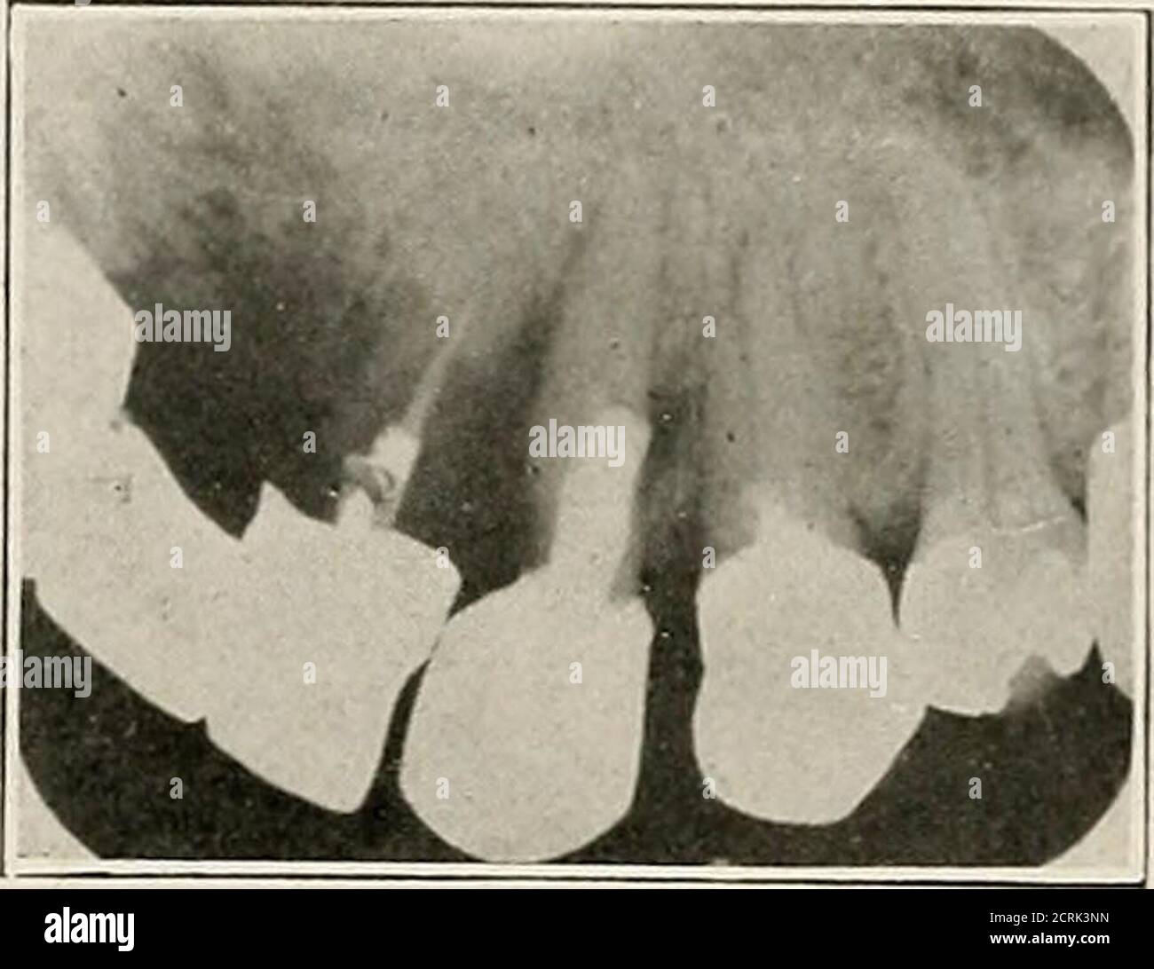 . Interpretation of dental and maxillary roentgenograms . Fig. 70. Fig ...