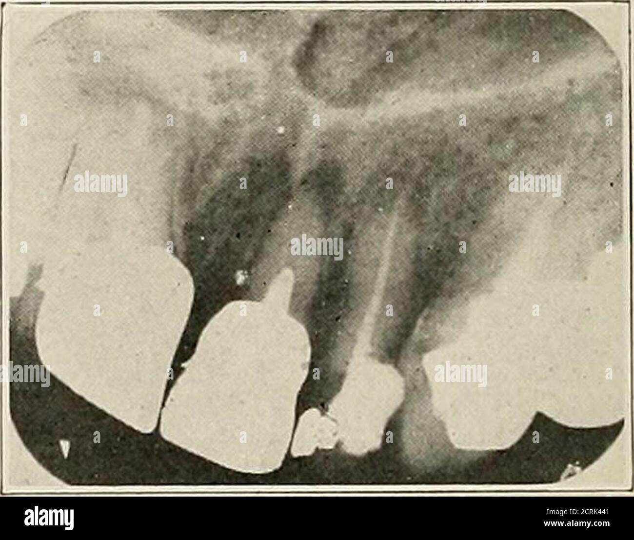 . Interpretation of dental and maxillary roentgenograms . Fig. 68. Fig ...