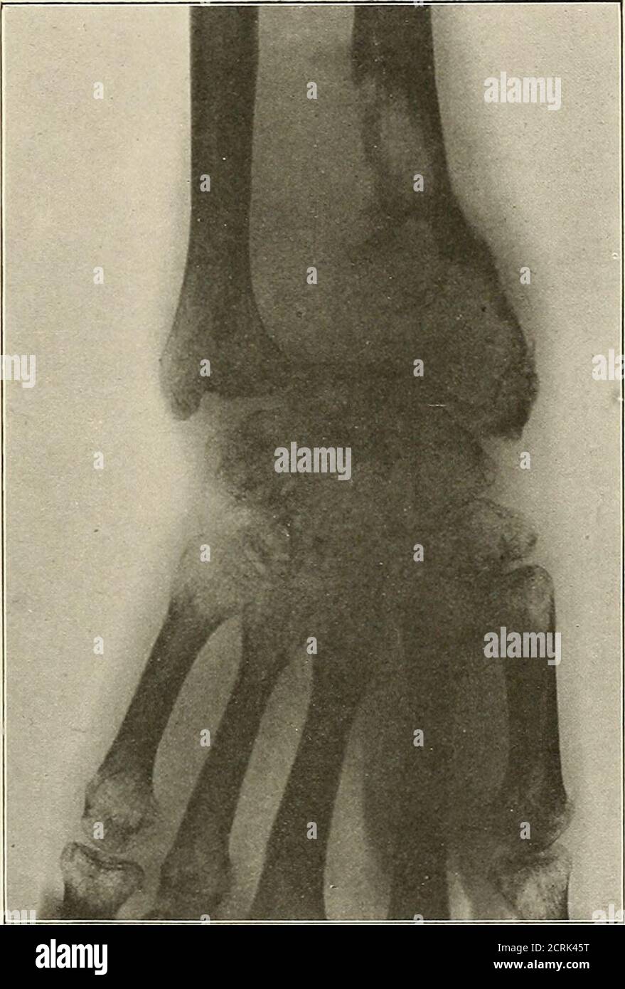 . A radiographic atlas of the pathologic changes of bones and joints ...