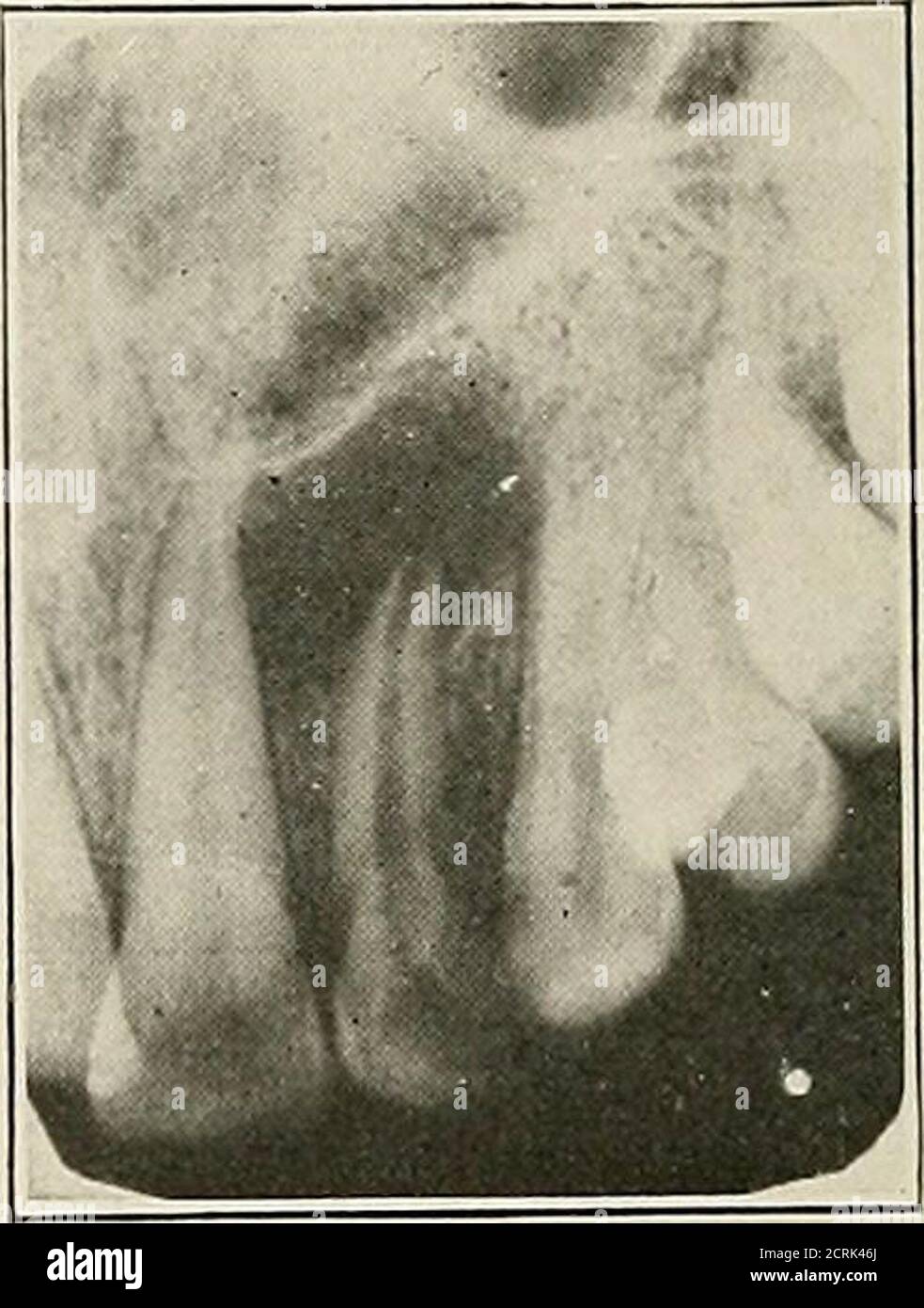 Granuloma periapical hi-res stock photography and images - Alamy